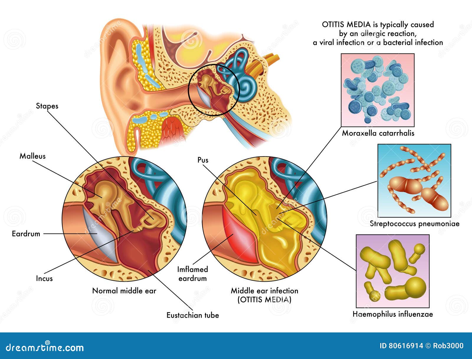 Media de Otitis ilustración del vector. Ilustración de poner - 80616914
