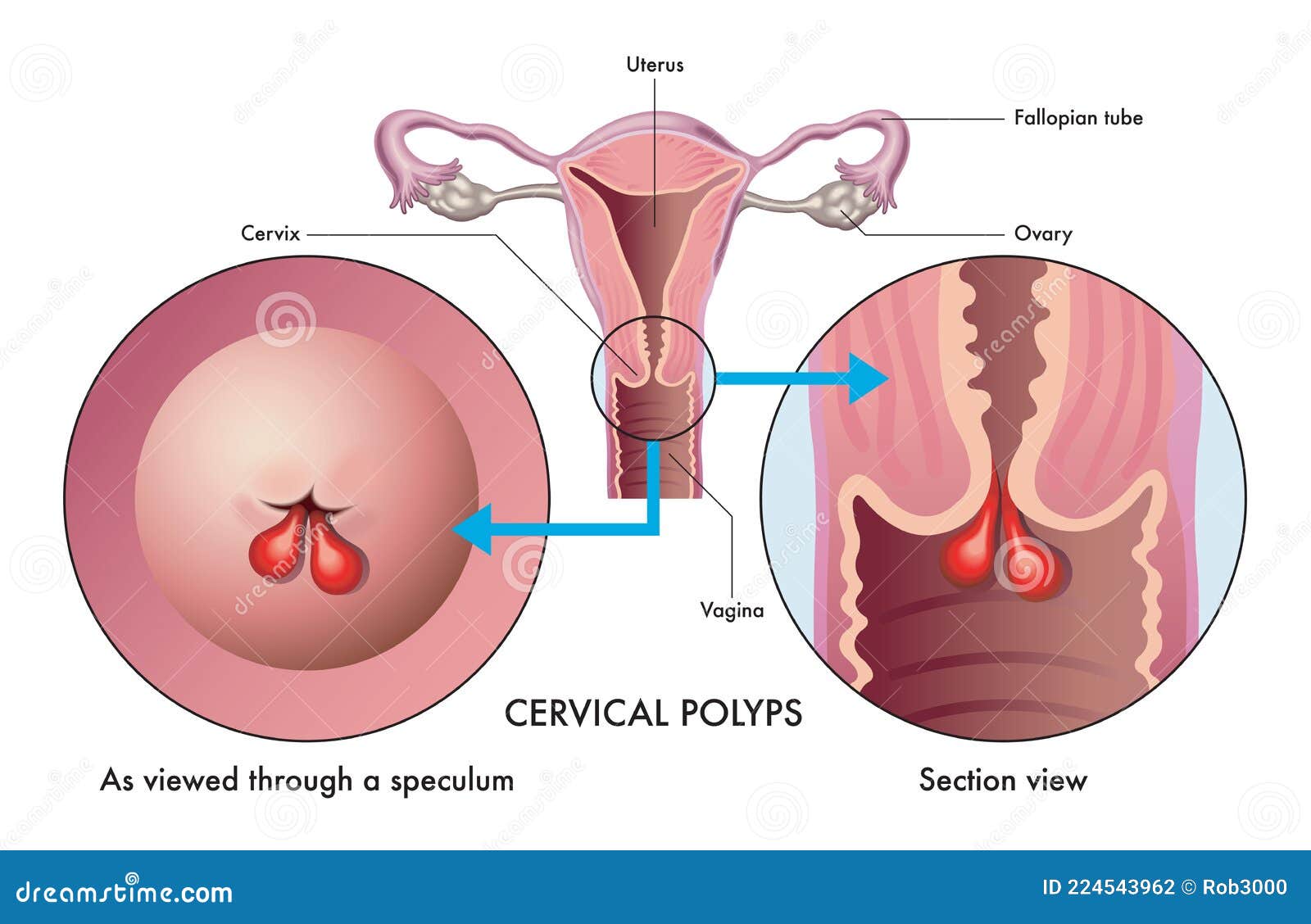 Types Of Cervical Polyps
