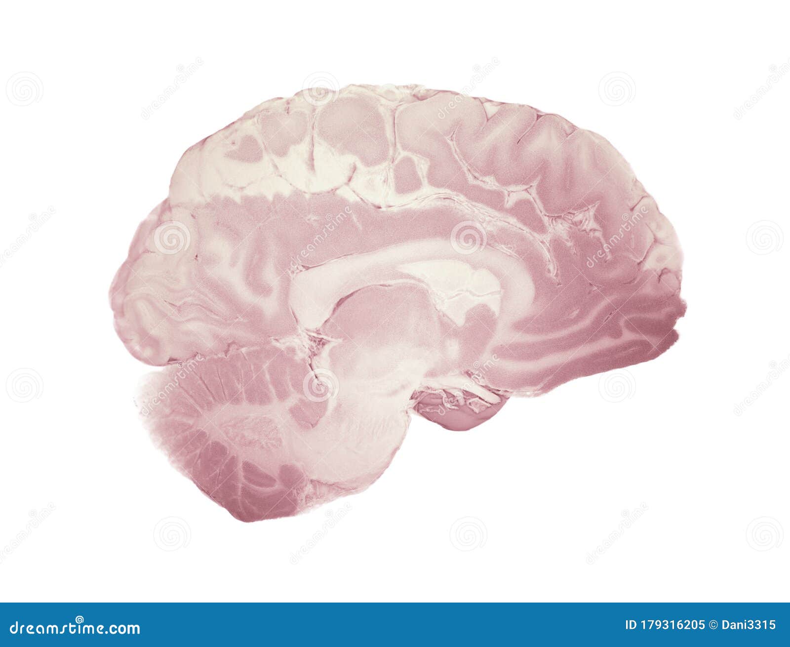 Median Section Of Lumbar Spine, Systemic Veins And The Portal System ...