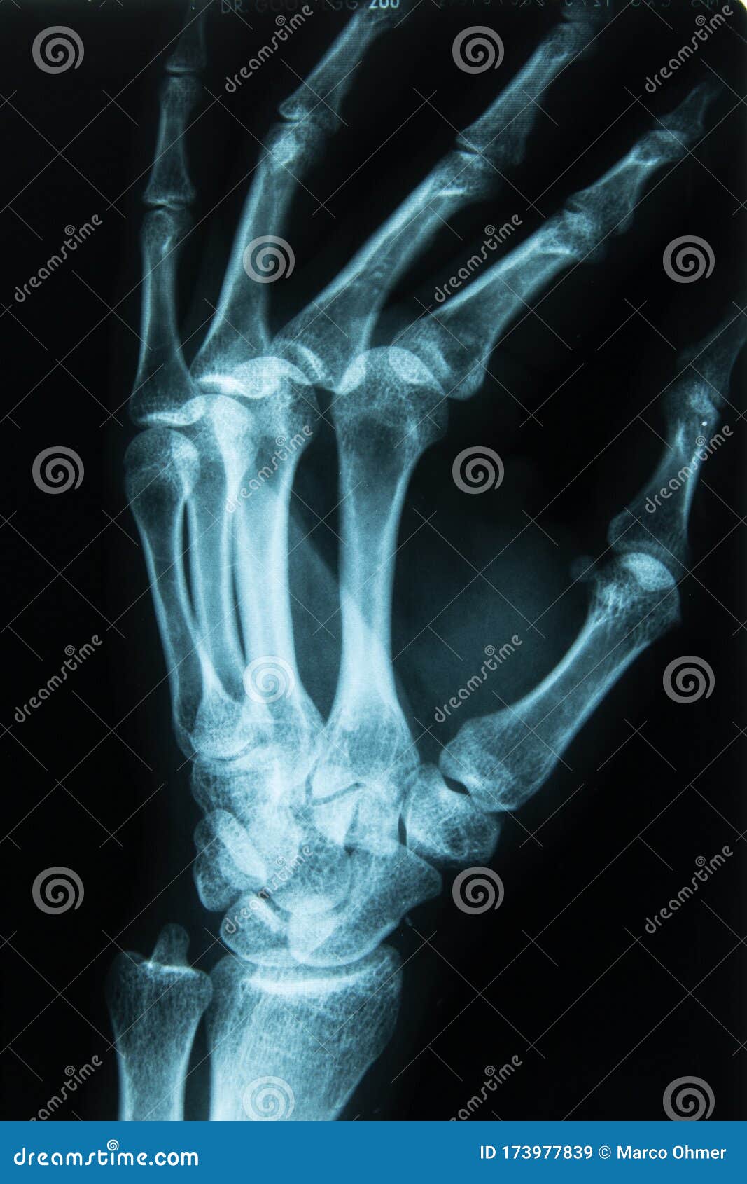 Medical Xray Scan of a Hand Stock Image - Image of black, patient ...