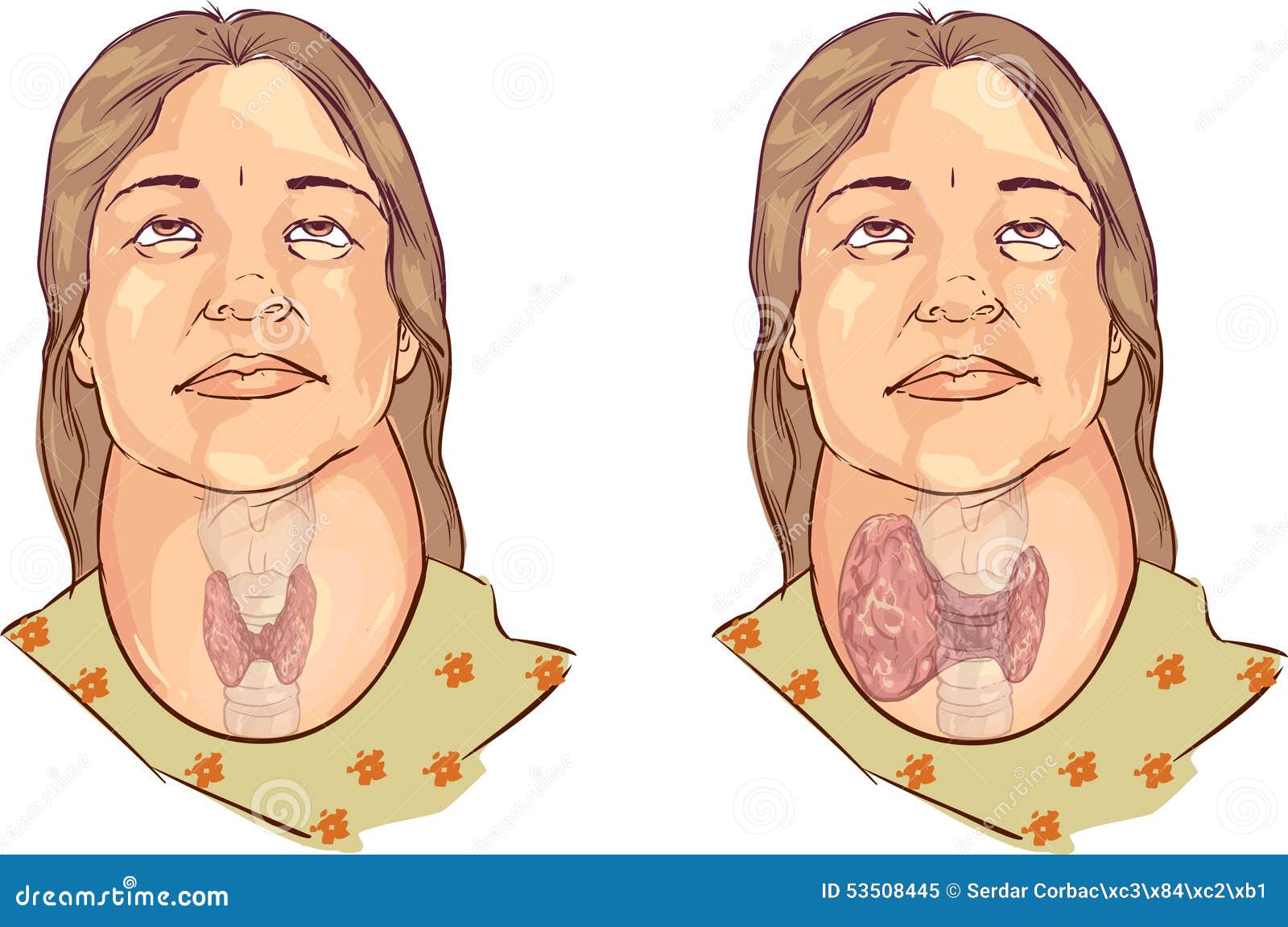 Medical Illustration Of Goiter Stock Vector - Image: 53508445