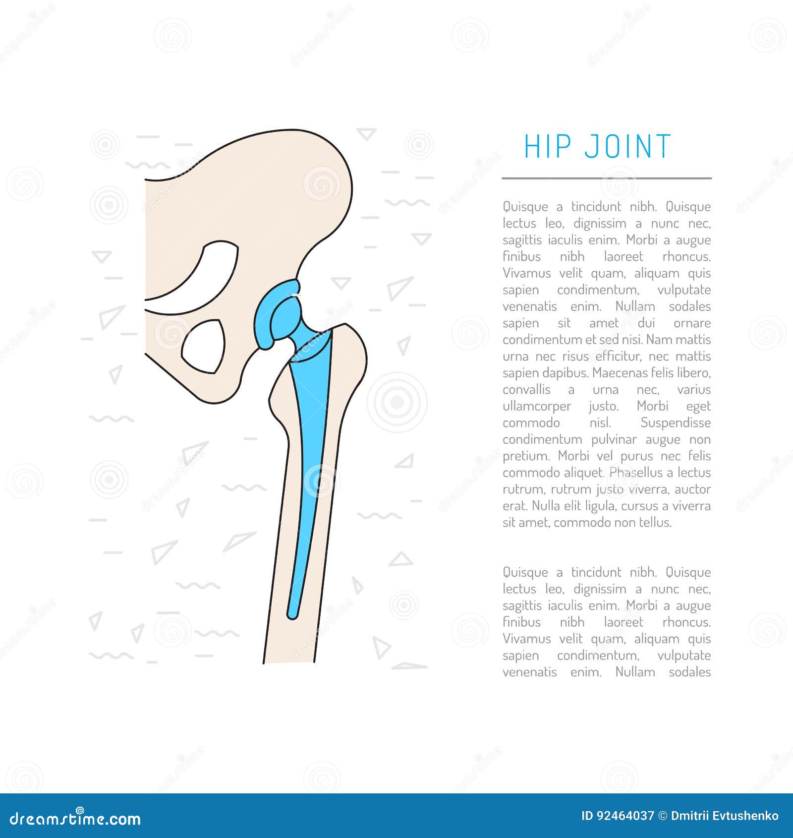 Medical Illustration Hip Joint Stock Vector - Illustration of arthritis ...
