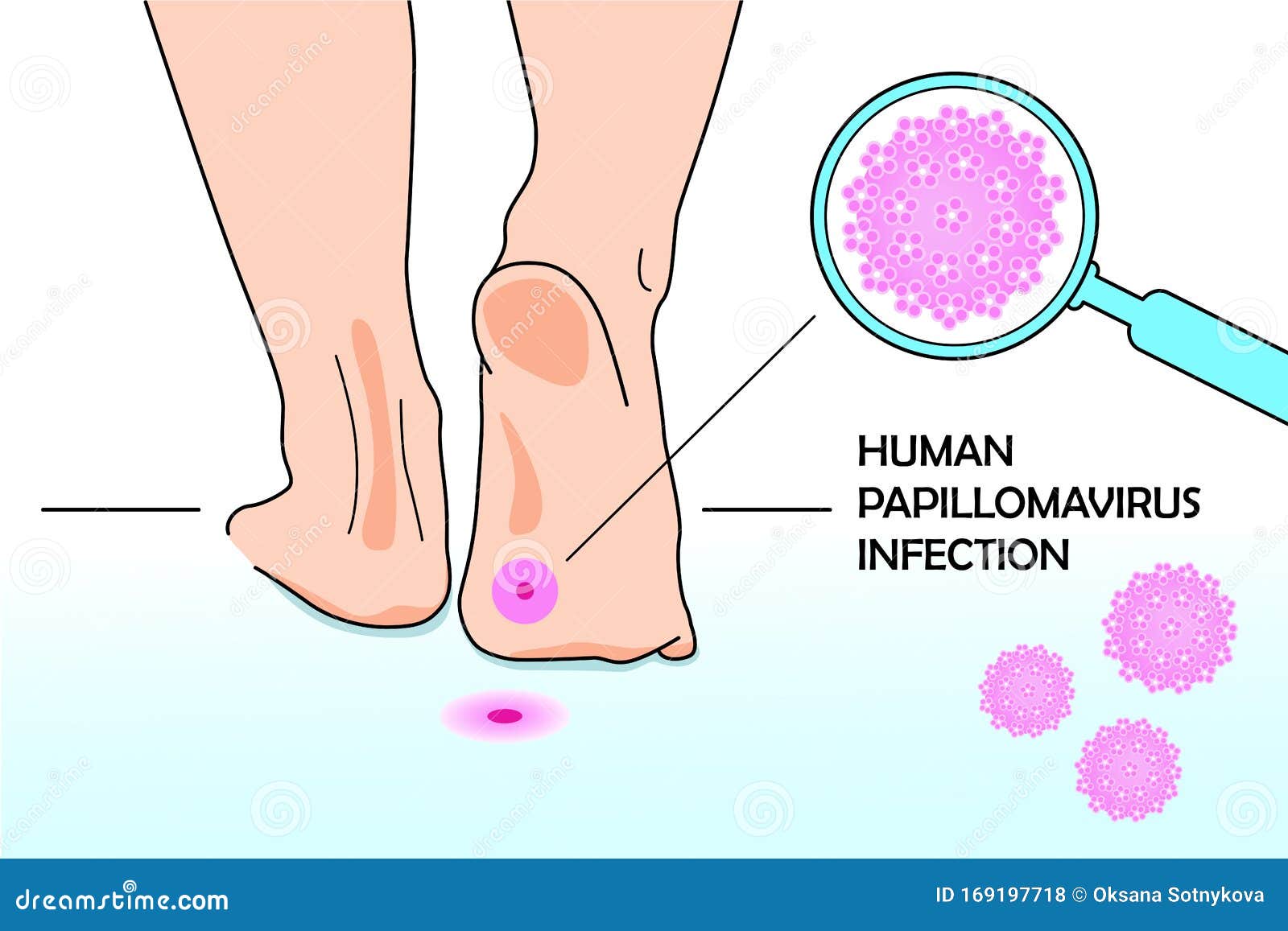 Medical Illustration Of An Infection Of The Dna Virus Human Papillomovirus Feet On The Floor