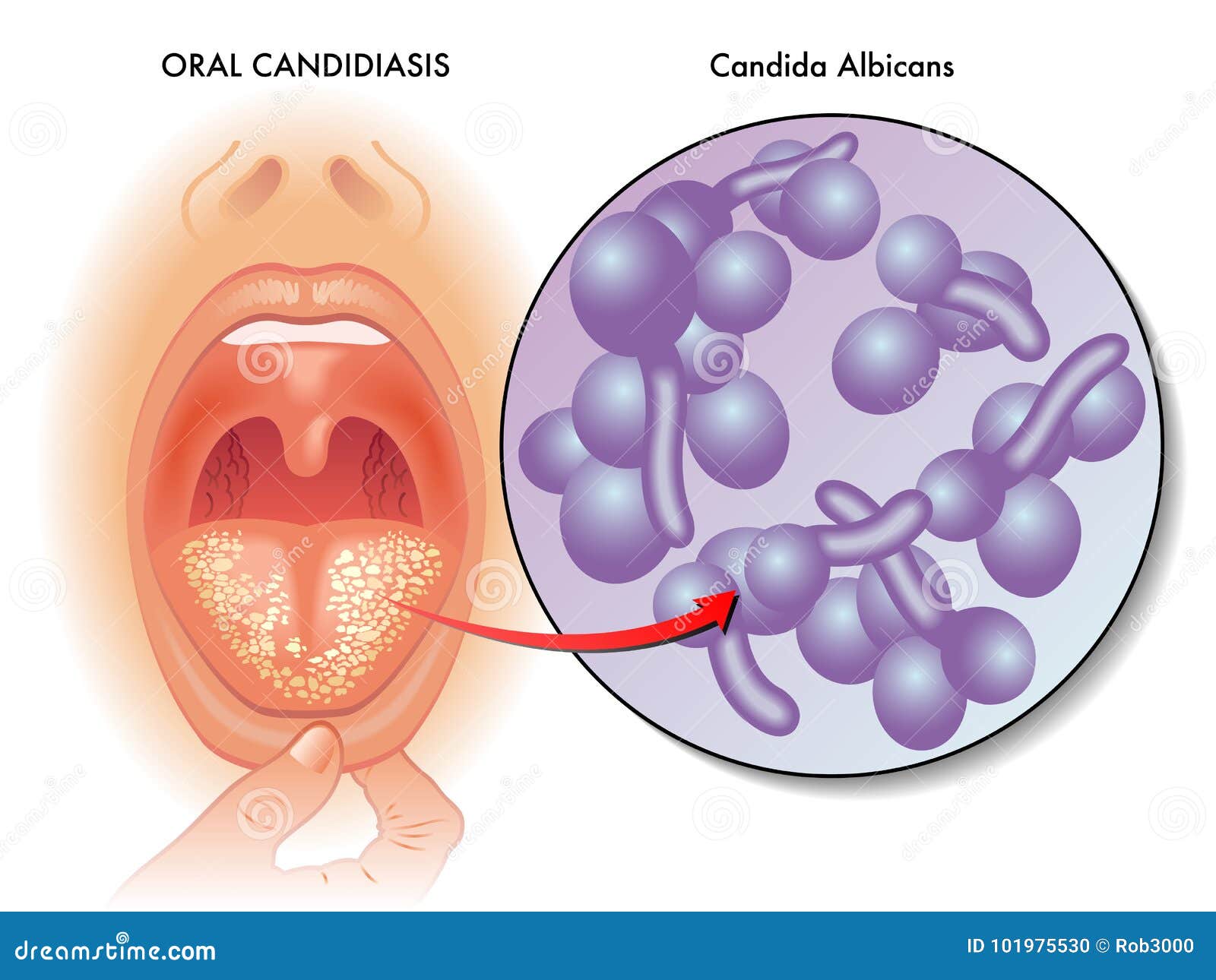 Medical Illustration Of Oral Candidiasis Stock Vector Illustration Of Macro Oral 101975530