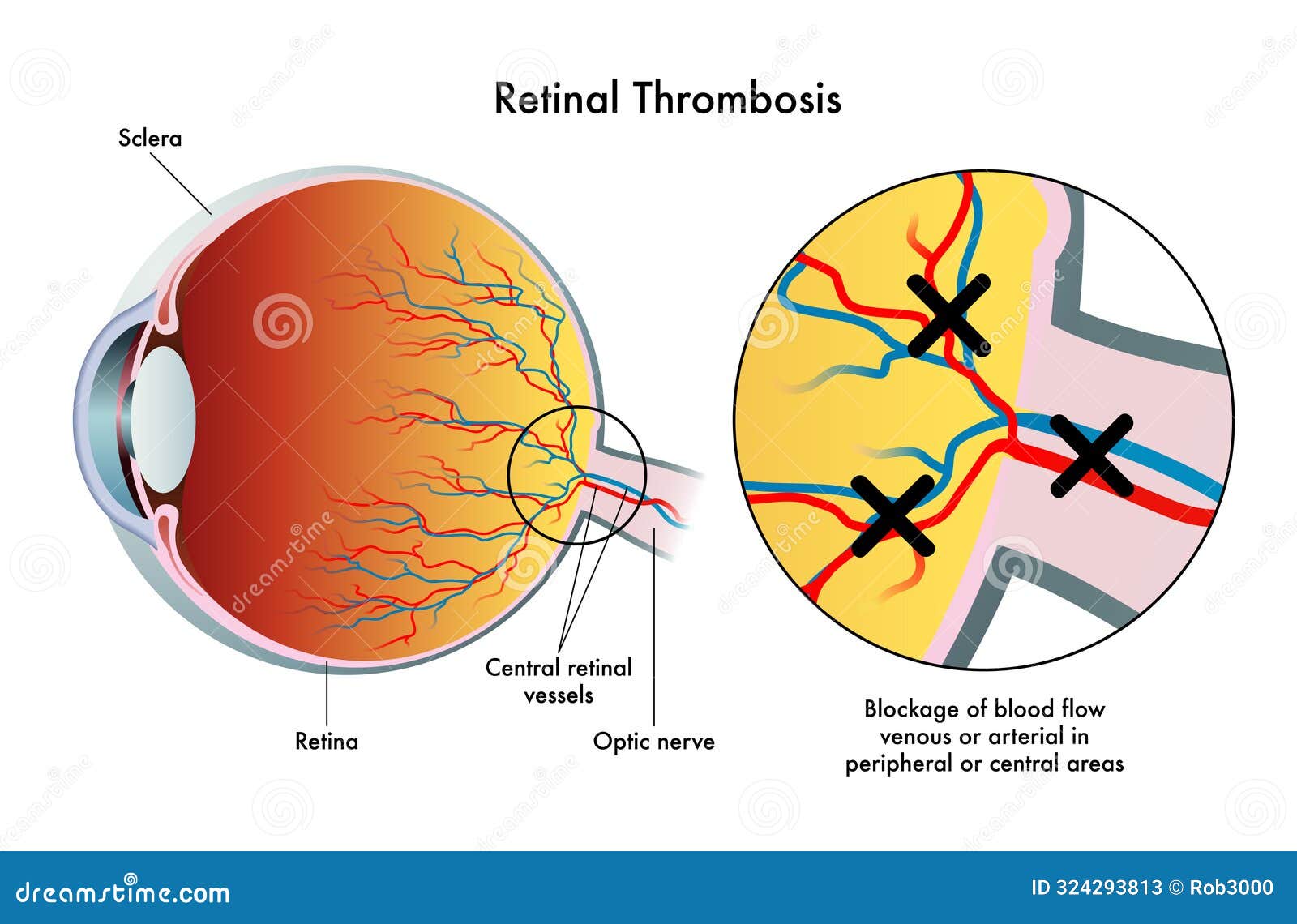 Medical Illustration Of Retinal Thrombosis Cartoon Vector ...