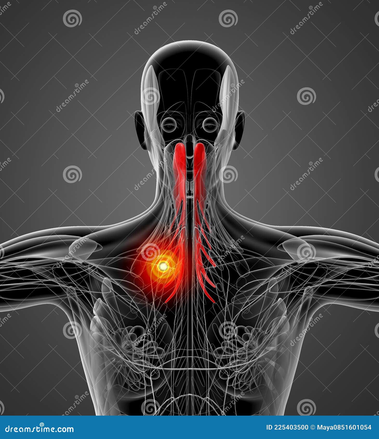 Medical Illustration of the Semispinalis Capitis Stock Illustration ...