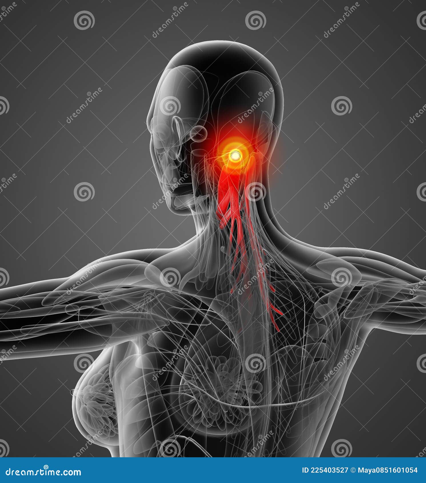 Medical Illustration of the Semispinalis Capitis Stock Illustration ...