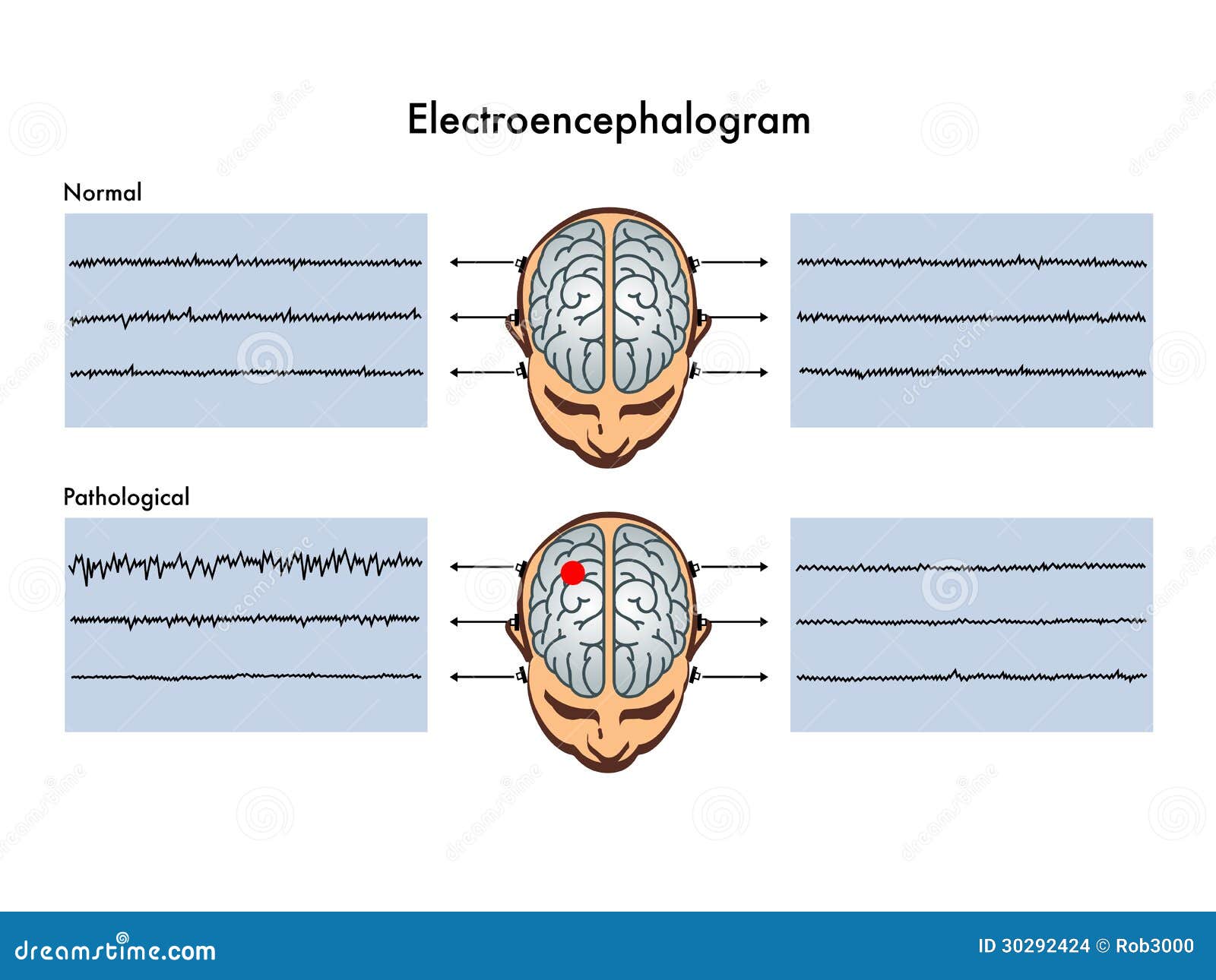 EEG Electroencephalogram, Brain Wave In Awake State During Rest Royalty ... EEG Electroencephalogram, Brain Wave In Awake State During Rest Royalty ...