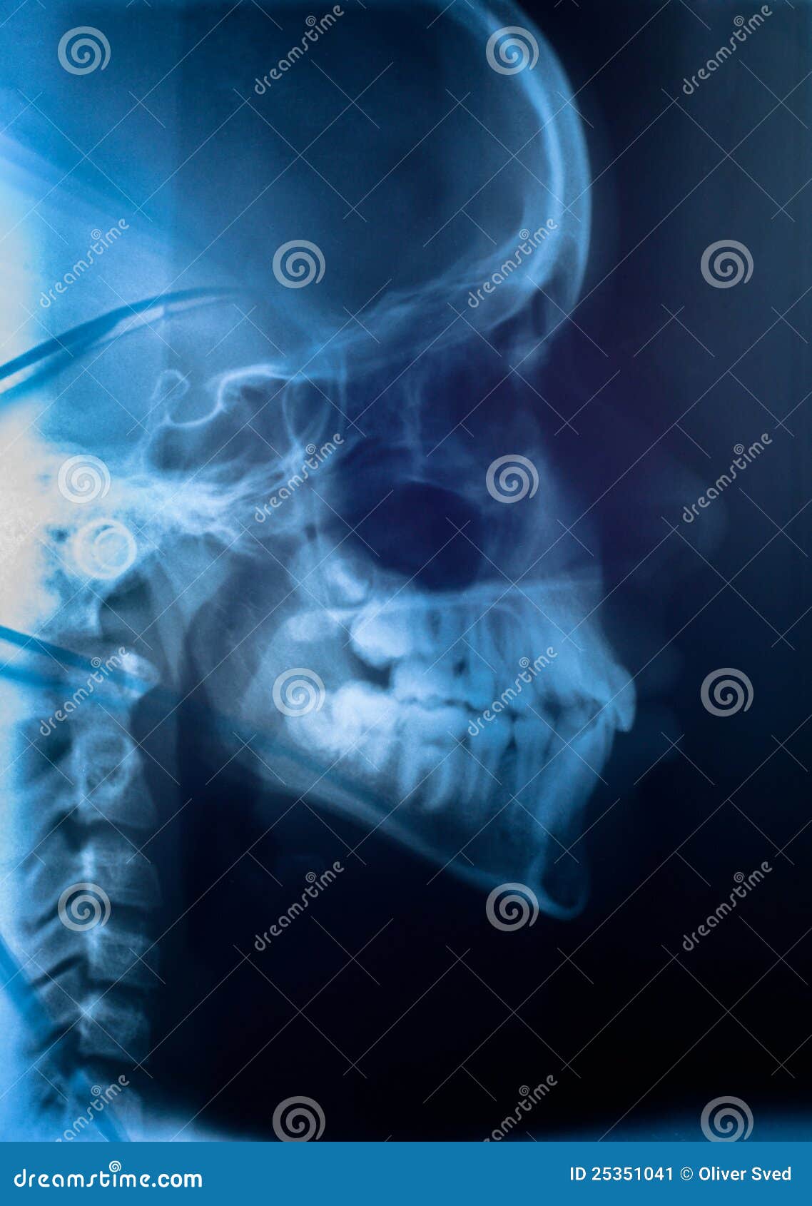 Medical Scan of the Human Head Stock Image - Image of health, imaging ...