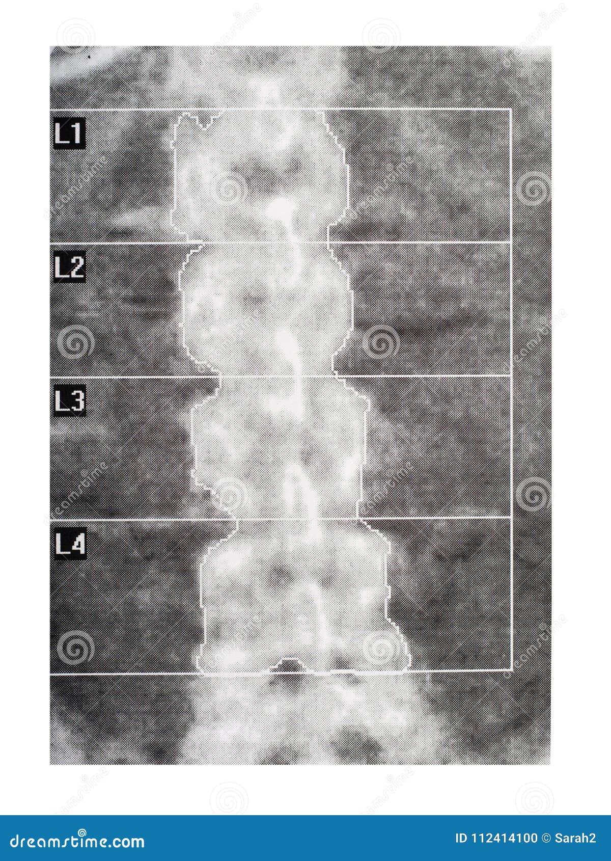 Bone Density DEXA Scan. Osteoporosis Diagnosis. Stock Photography ... Bone Density DEXA Scan. Osteoporosis Diagnosis. Stock Photography ...