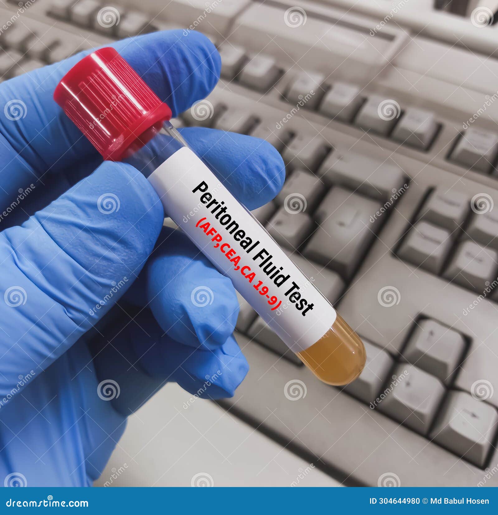 Medical Technologist Hold Peritoneal Fluid Sample for Peritoneal Fluid ...