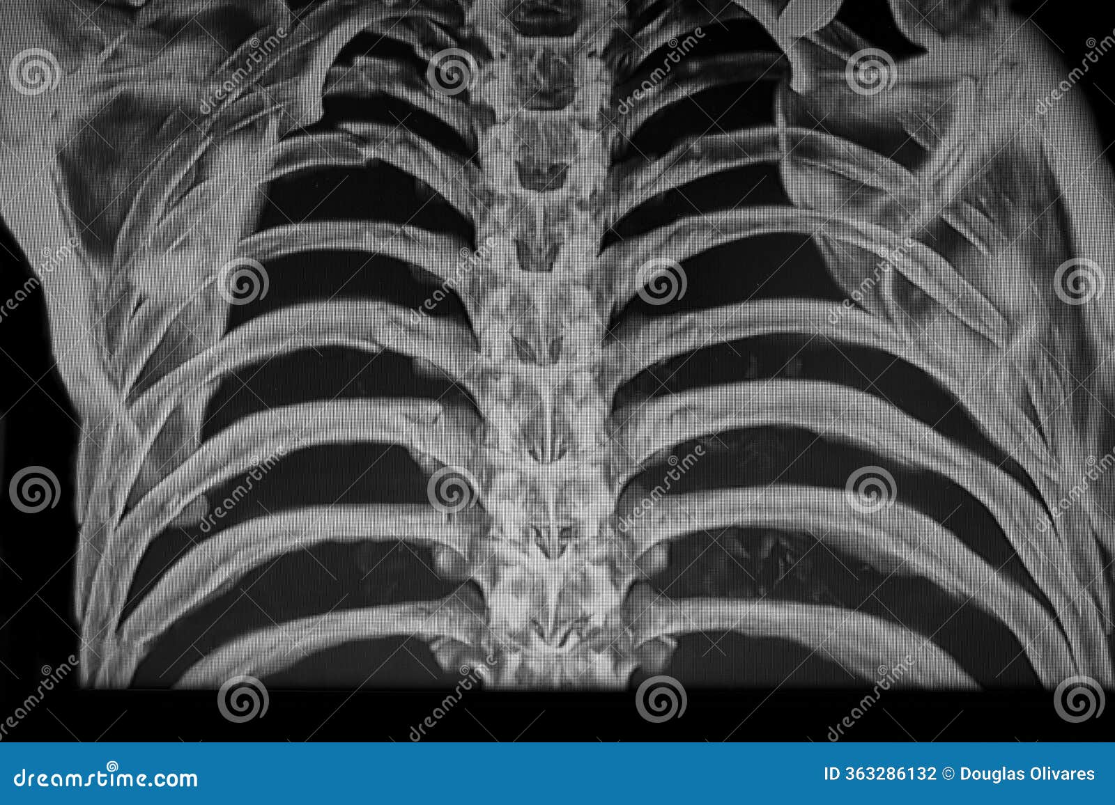Chest X- Ray that Shows Broken Ribs Stock Photo - Image of organ ...