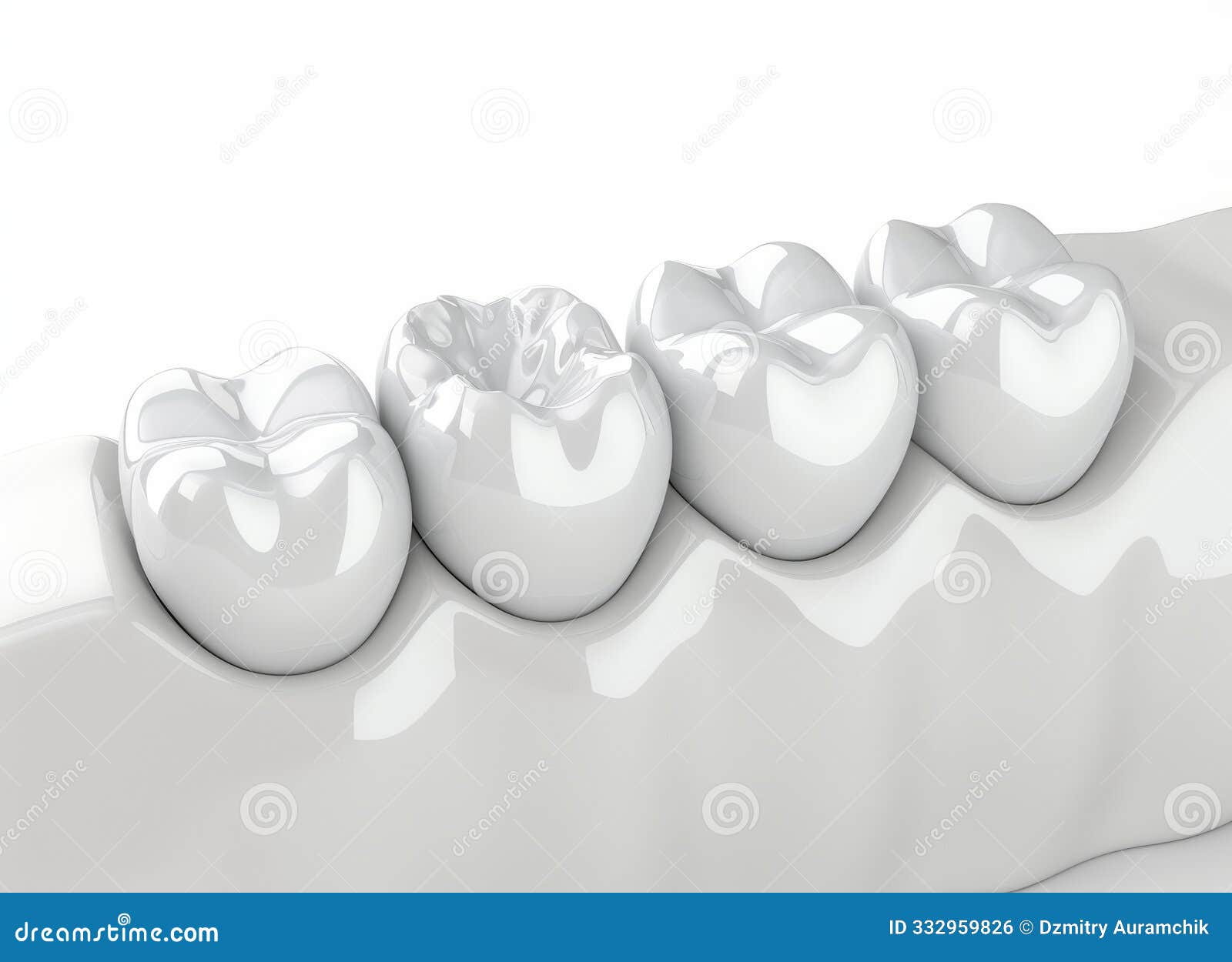 A Medically Accurate 3D Animation of Inlay Ceramic Crown Placement ...