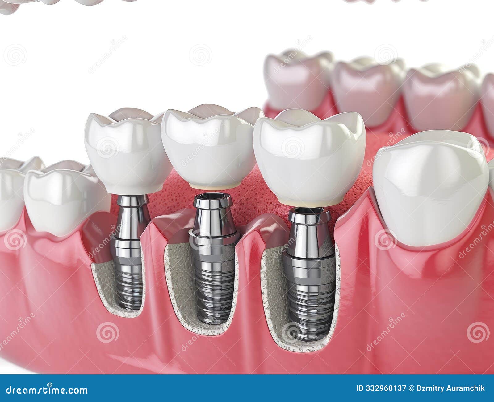 Medically Accurate 3D Illustration of Human Teeth and Dentures ...