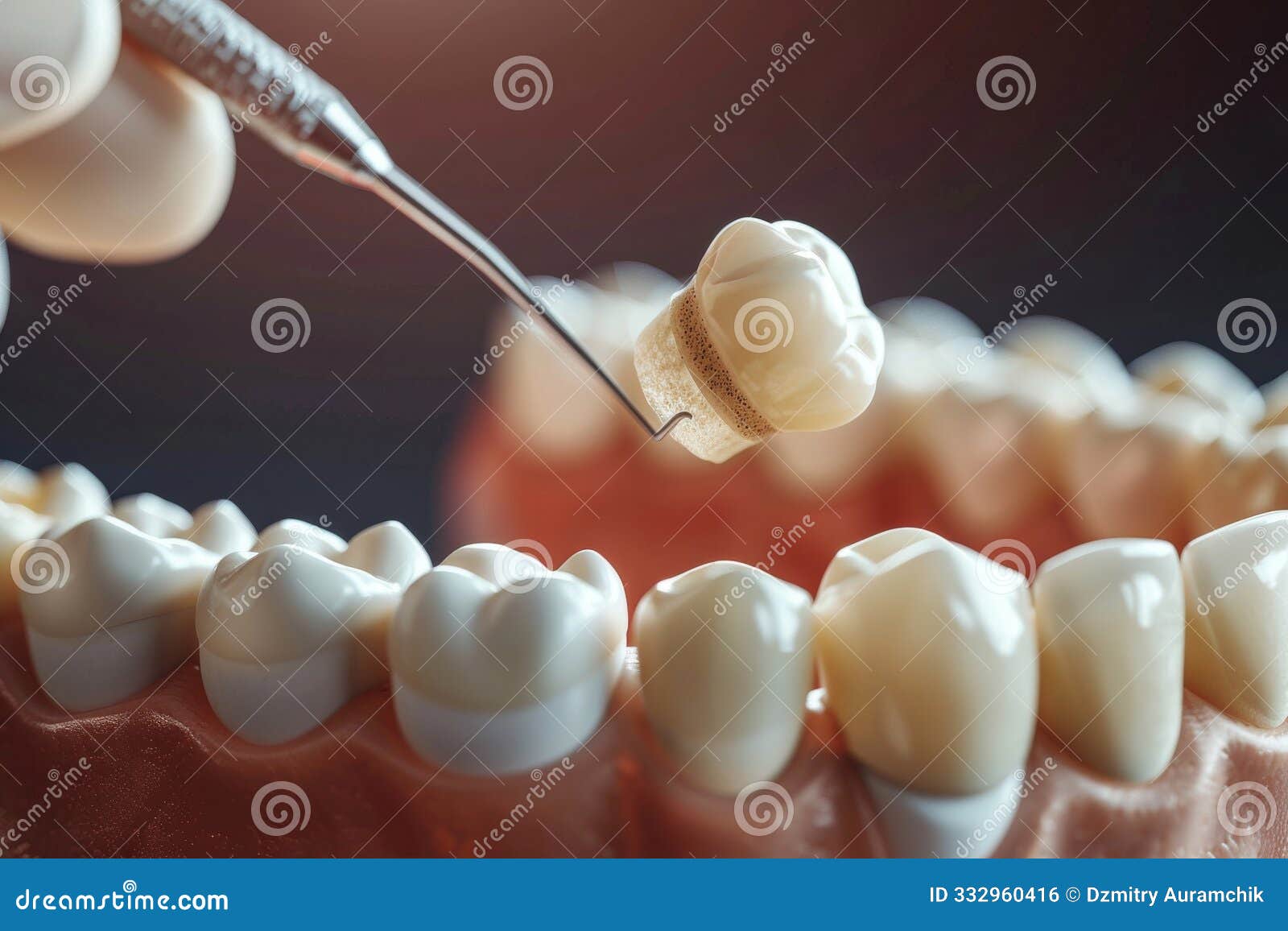 A Medically Accurate Illustration of the Molar Preparation Process for ...
