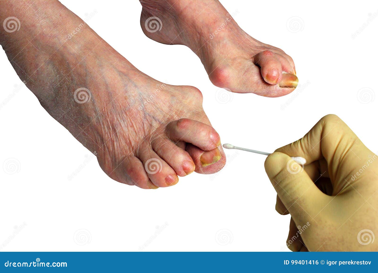 Medicine, Valgus Bunion, Leg with Deformity Valgus Hallux Bunion, Stock ...