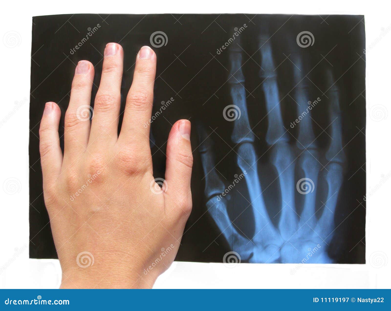 Medizinisches Exemplar Einer Gebrochenen Hand Stockbild - Bild von ...