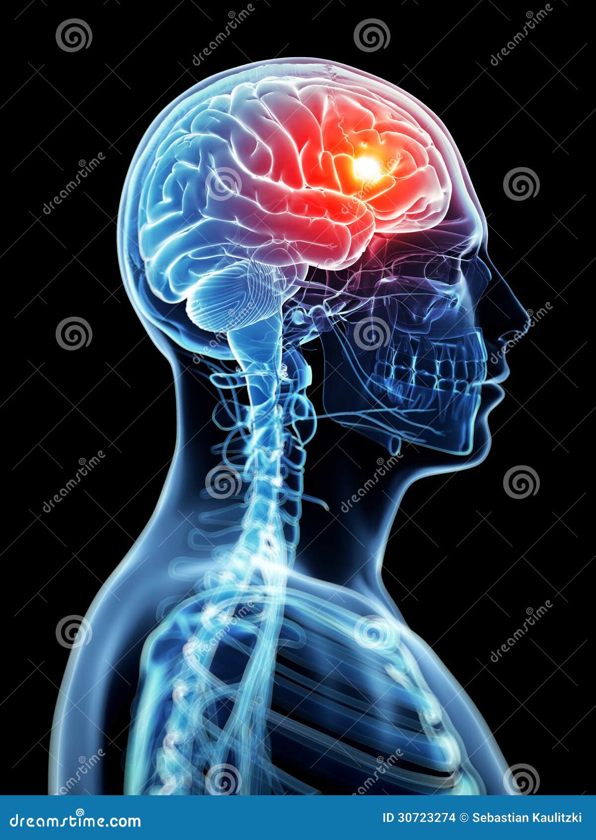 Headache X-ray Scan Of Human Head With Brain Side View Stock Photo ...