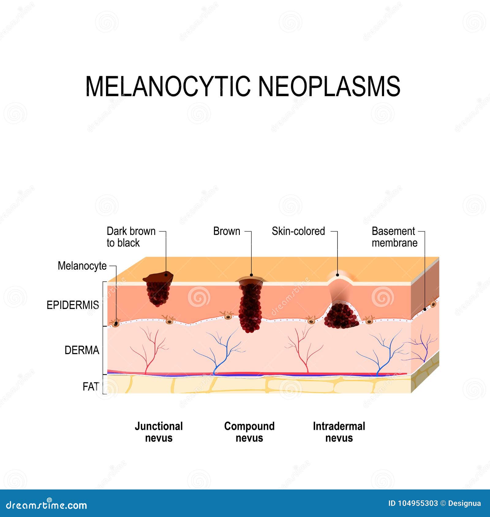 Melanocytic Muttermal Unterschied Zwischen Einem Muttermal, Einer Mole ...