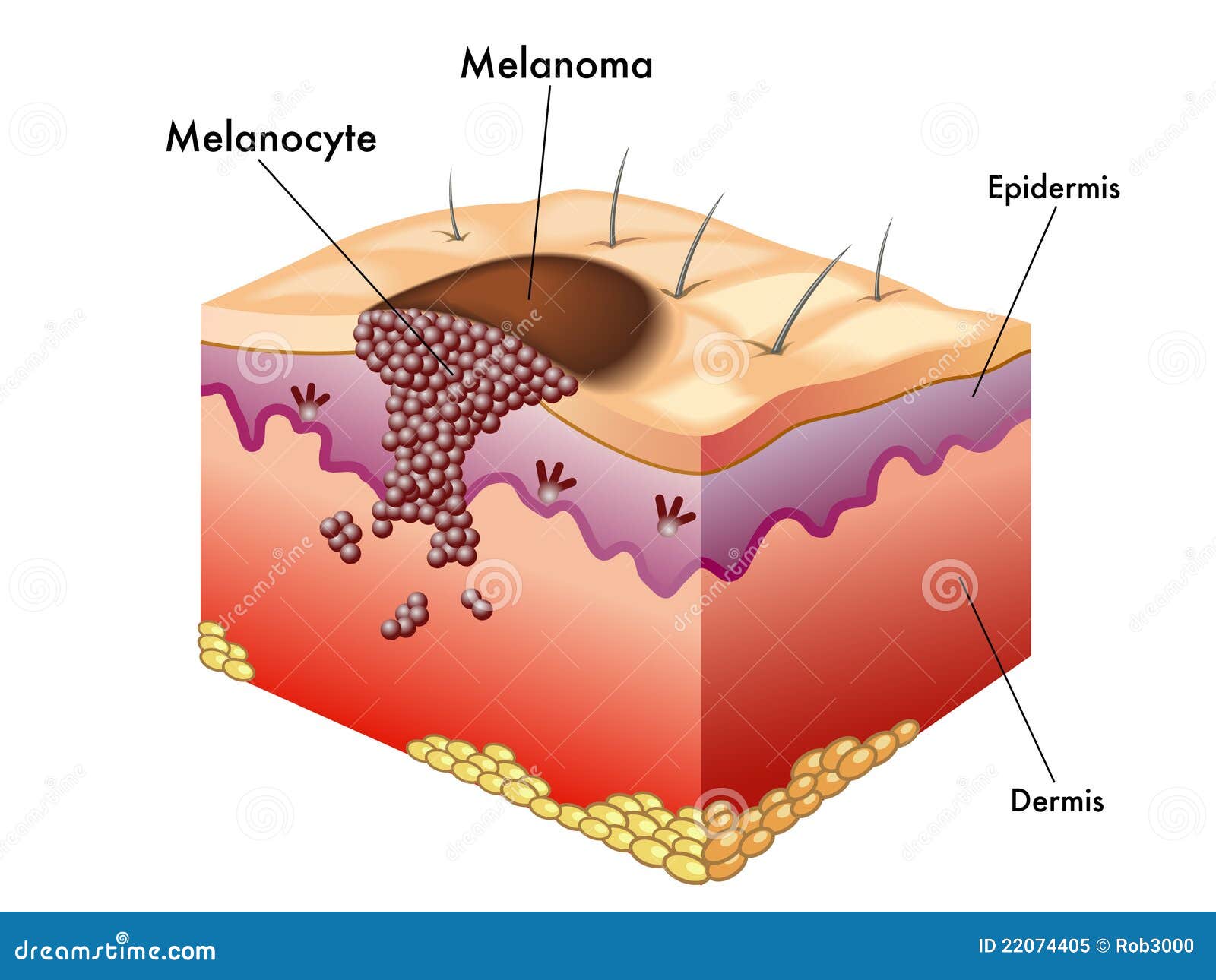 Melanoma Cartoons, Illustrations & Vector Stock Images - 1409 Pictures ...
