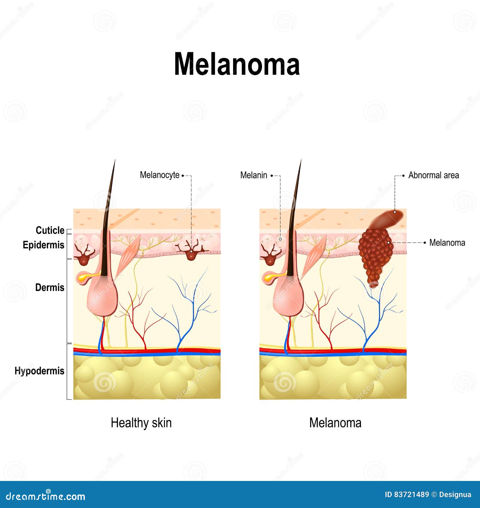 Melanoma Or Skin Cancer Stock Vector Illustration Of Anatomy 83721489