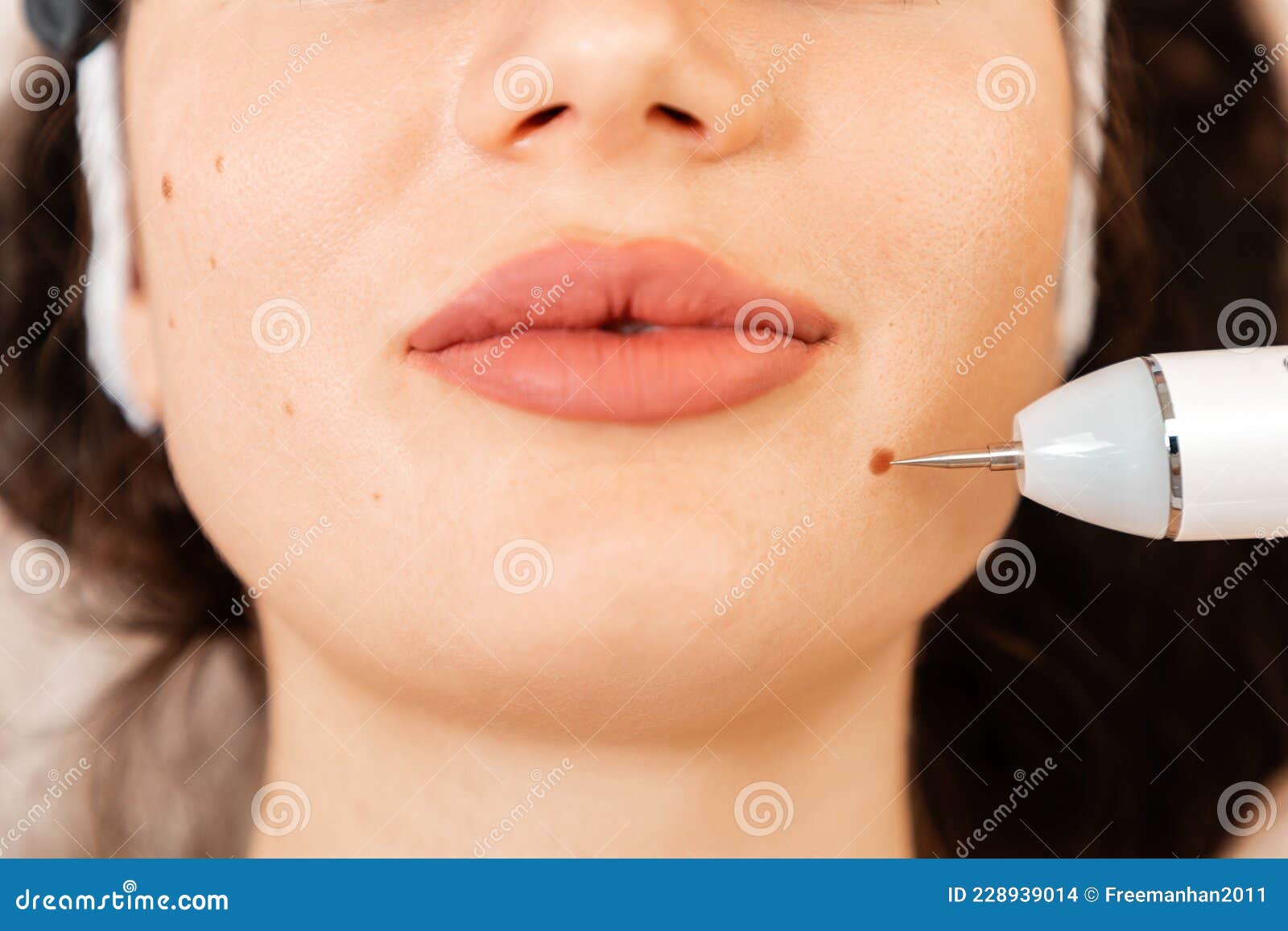 Electrocoagulation And Laser Cosmelotogy Dermatologist Using A