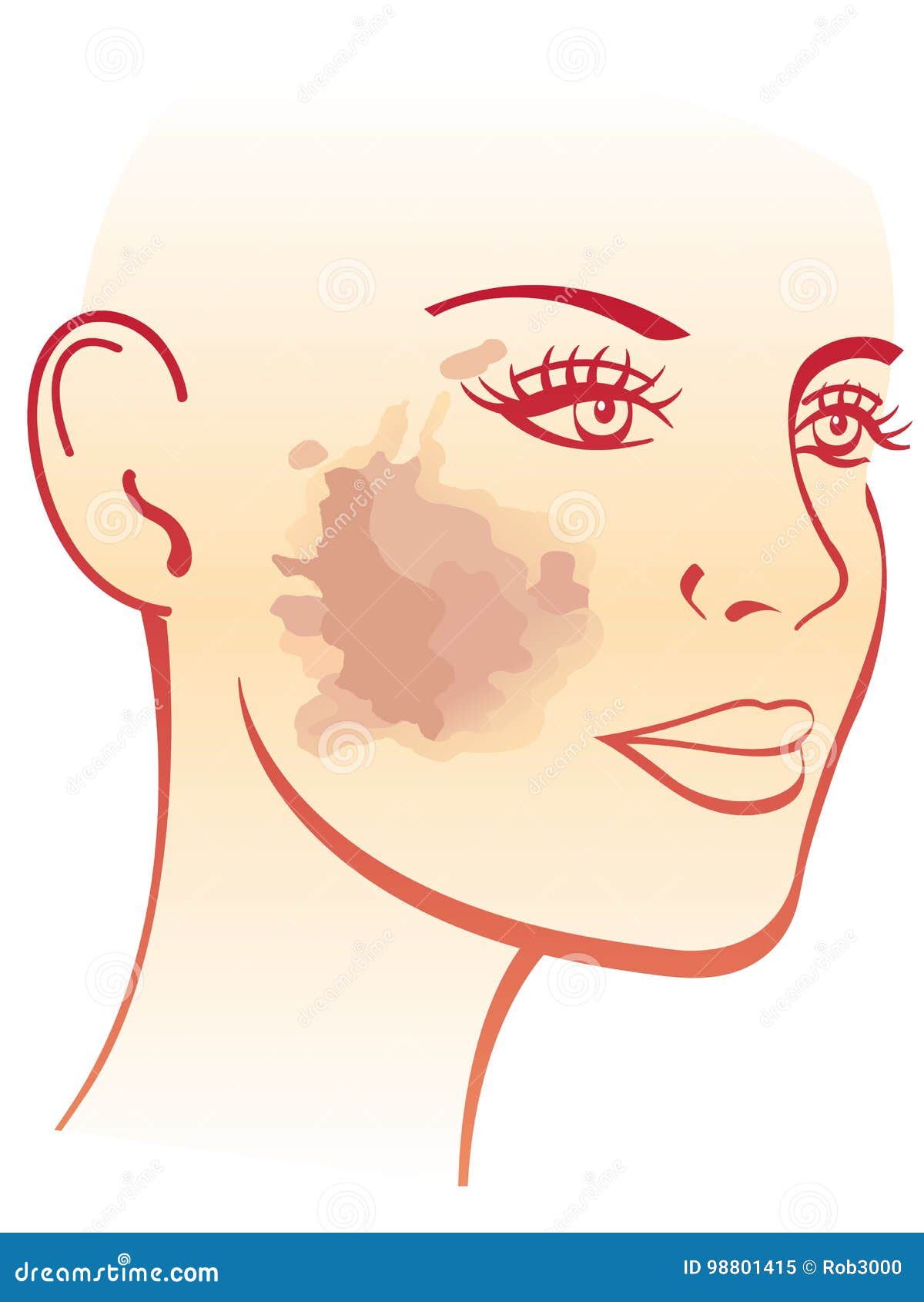 Melasma illustration stock vector. Illustration of female - 98801415