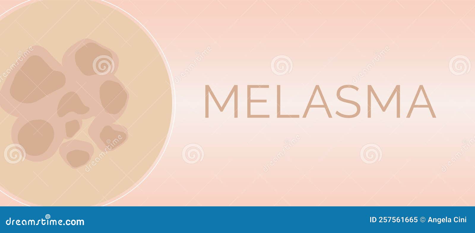 Melasma Illustration Cartoon Vector | CartoonDealer.com #98801415