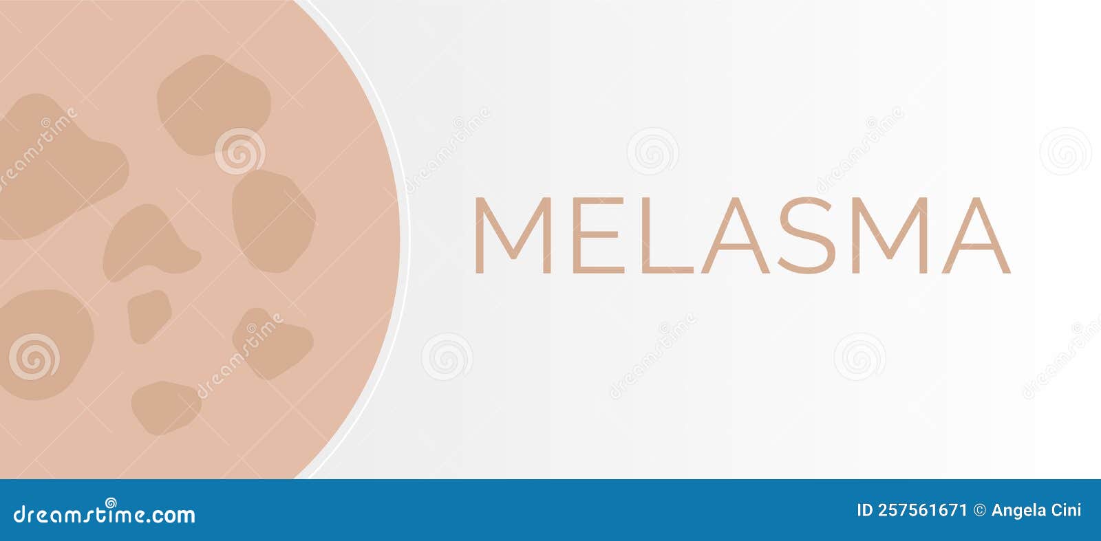 Melasma Skin Condition Illustration Vector Background Stock Vector ...