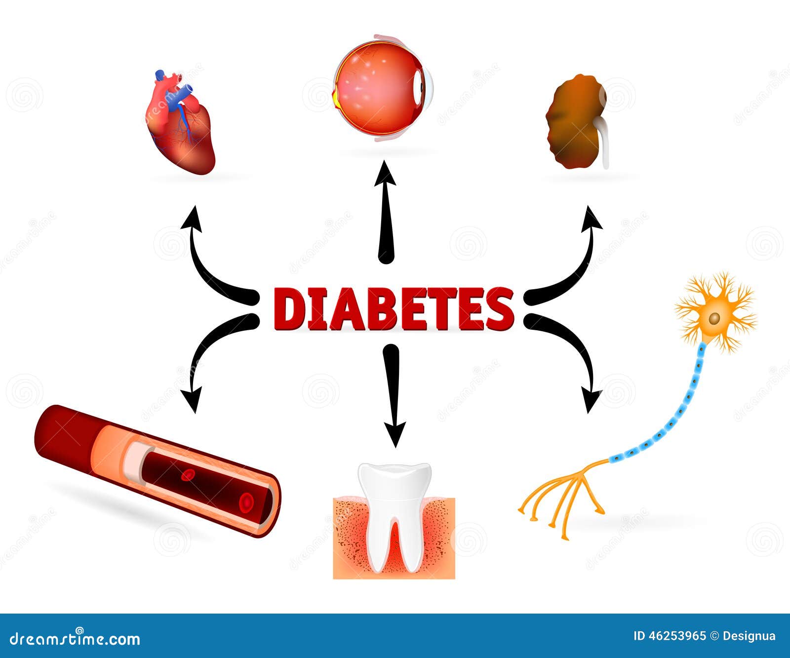 Mellitus Complicaties Van Diabetes Vector Illustratie - Afbeelding ...