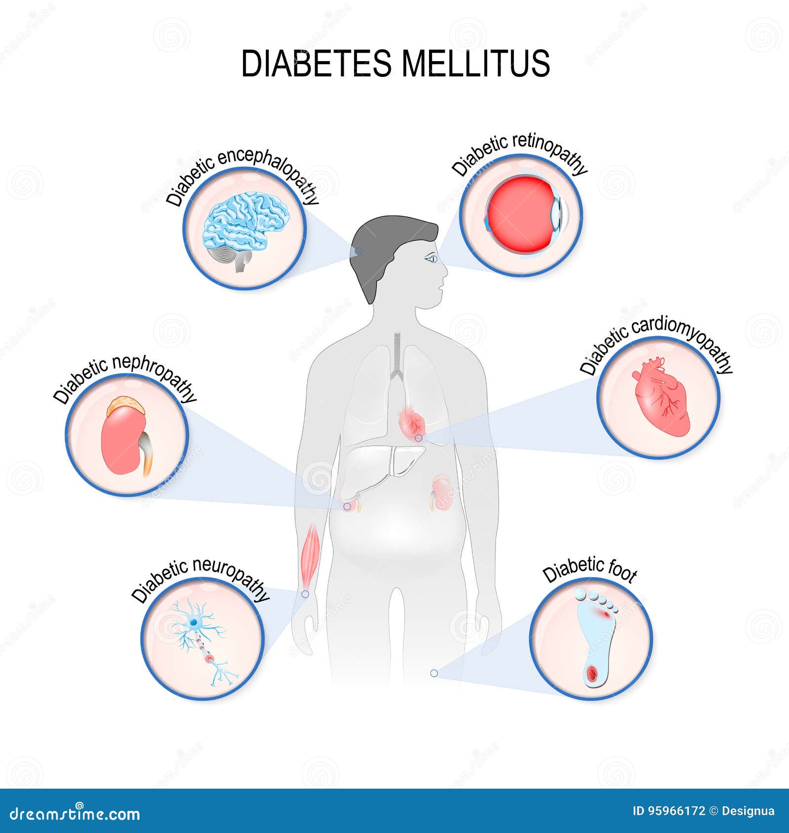 Mellitus Complicaties Van Diabetes Vector Illustratie - Illustration of ...