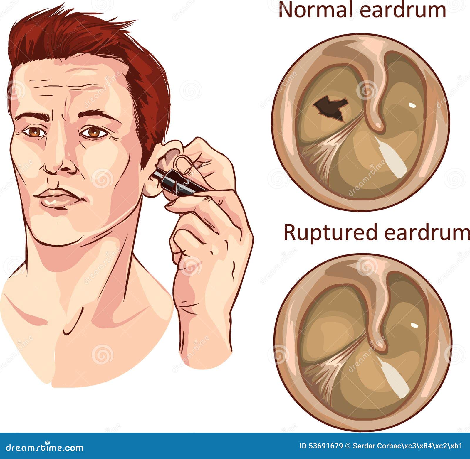 Membrana timpanica illustrazione vettoriale. Illustrazione di luce ...