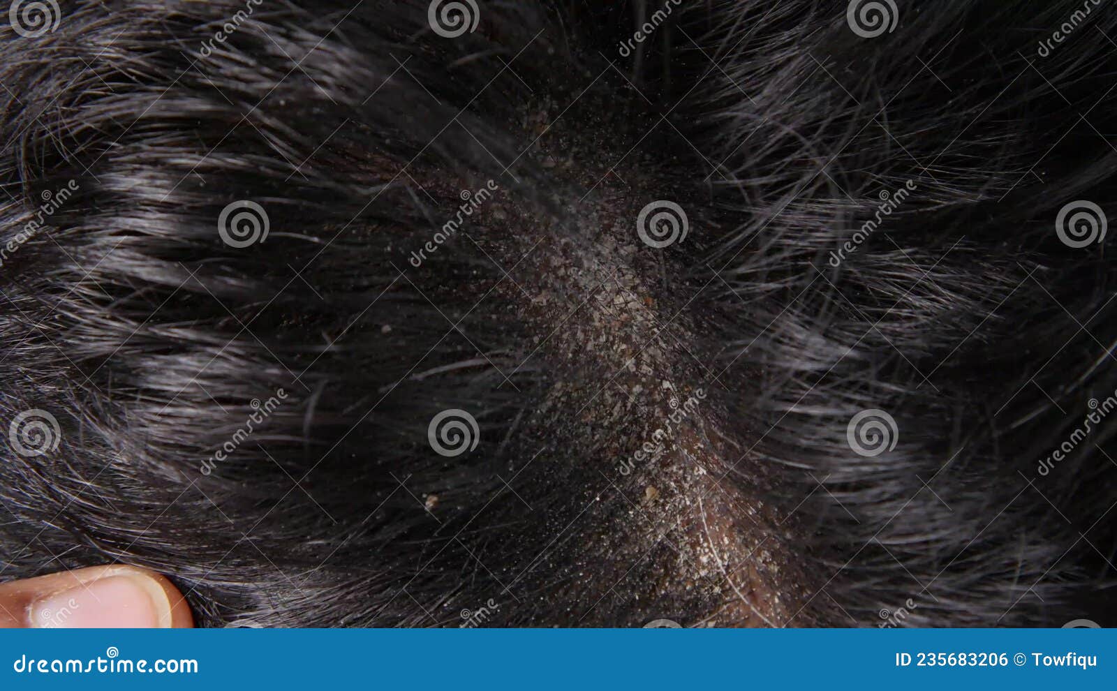 Men with Dandruff in His Hair, Closeup Stock Footage - Video of health ...