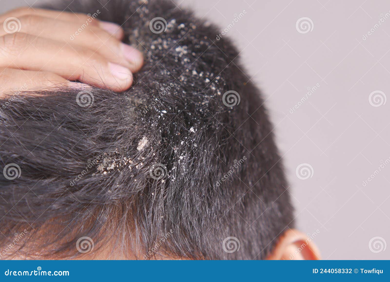 Men with Dandruff in His Hair, Closeup Stock Photo - Image of sensitive ...