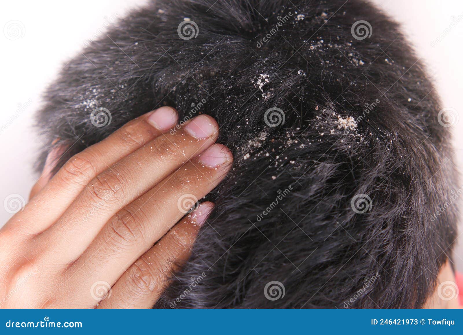 Men with Dandruff in His Hair, Closeup Stock Image - Image of fungal ...