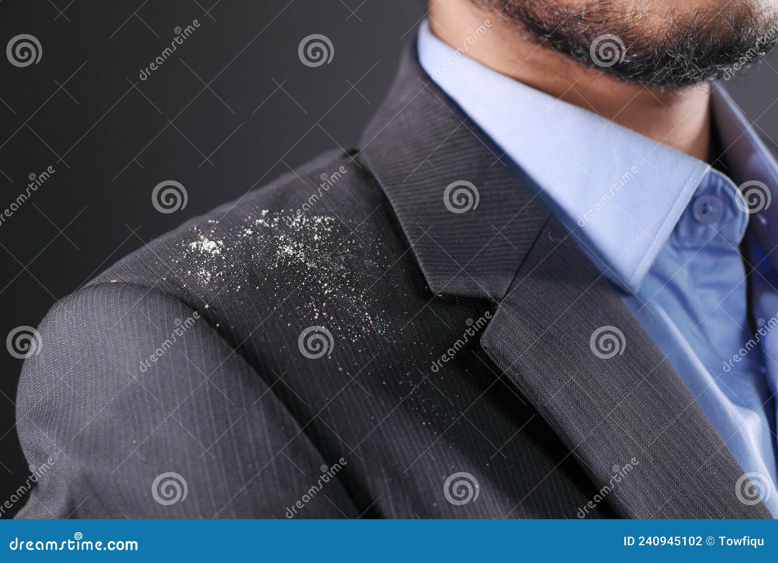 Men with Dandruff I on His Coat Stock Photo - Image of medical, scaly ...