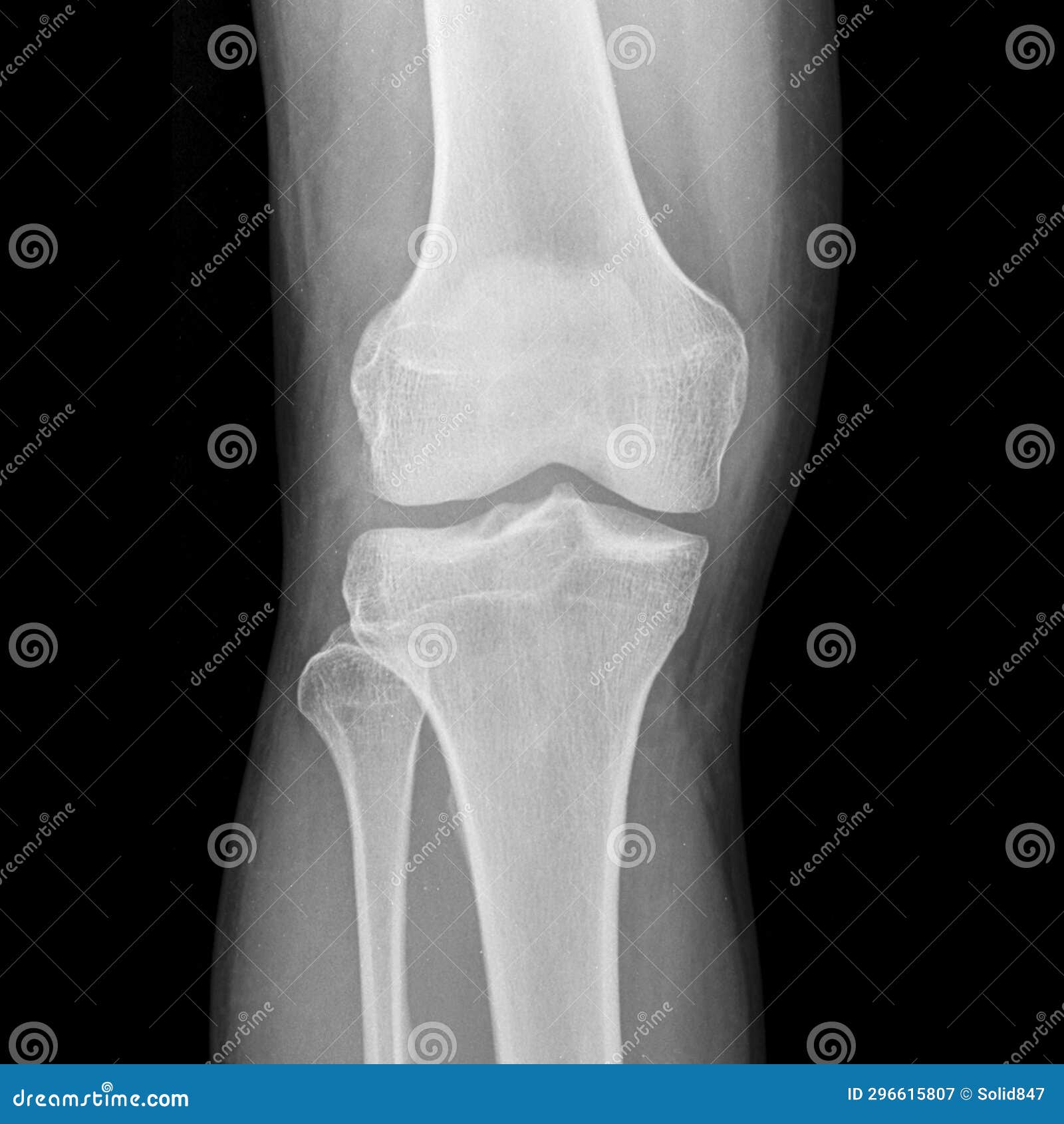 Knee Joint X Ray Image Ap View Stock Image - Image of body, bones ...