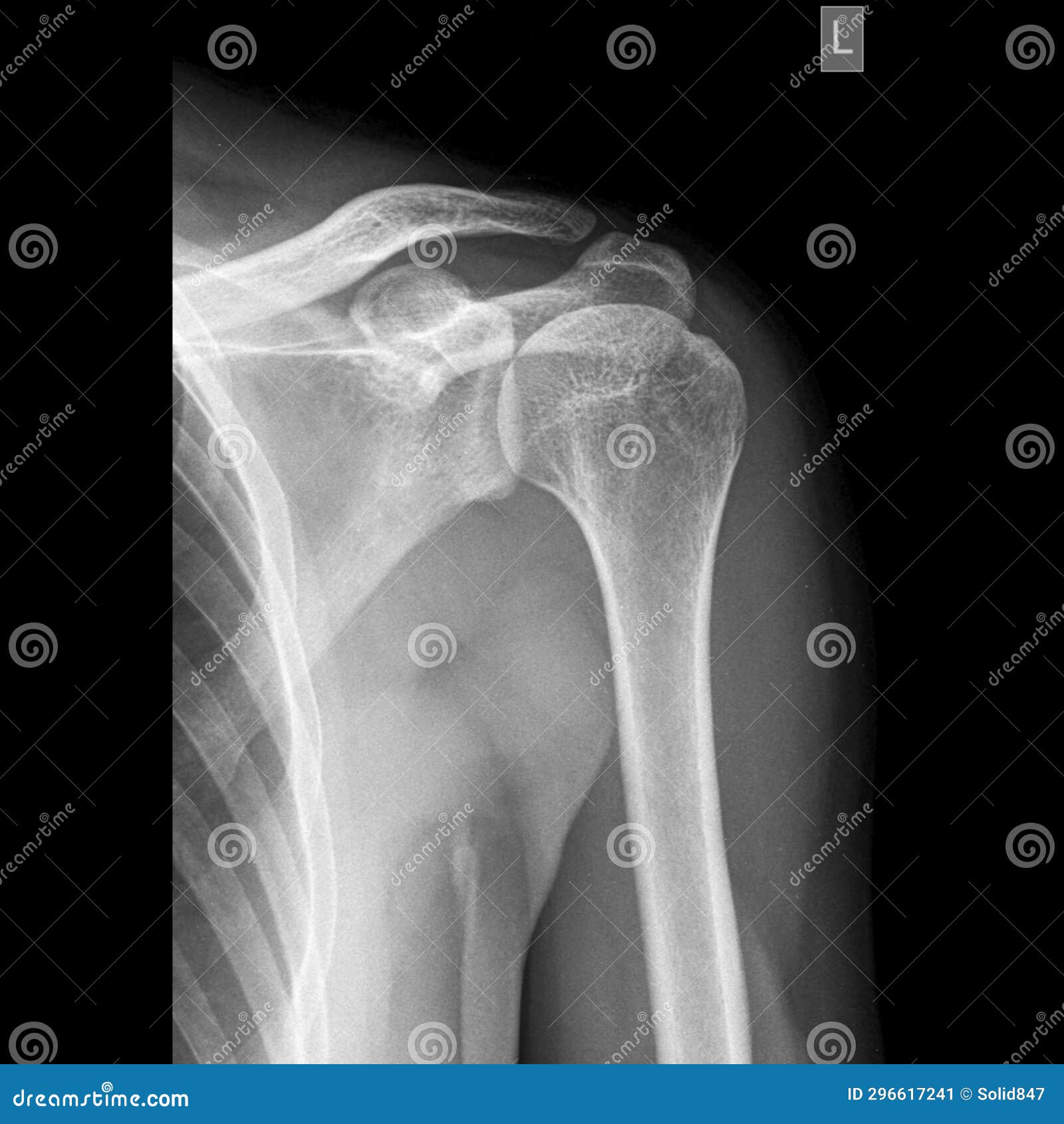 Shoulder Joint X-ray Image AP View Stock Image - Image of hand ...