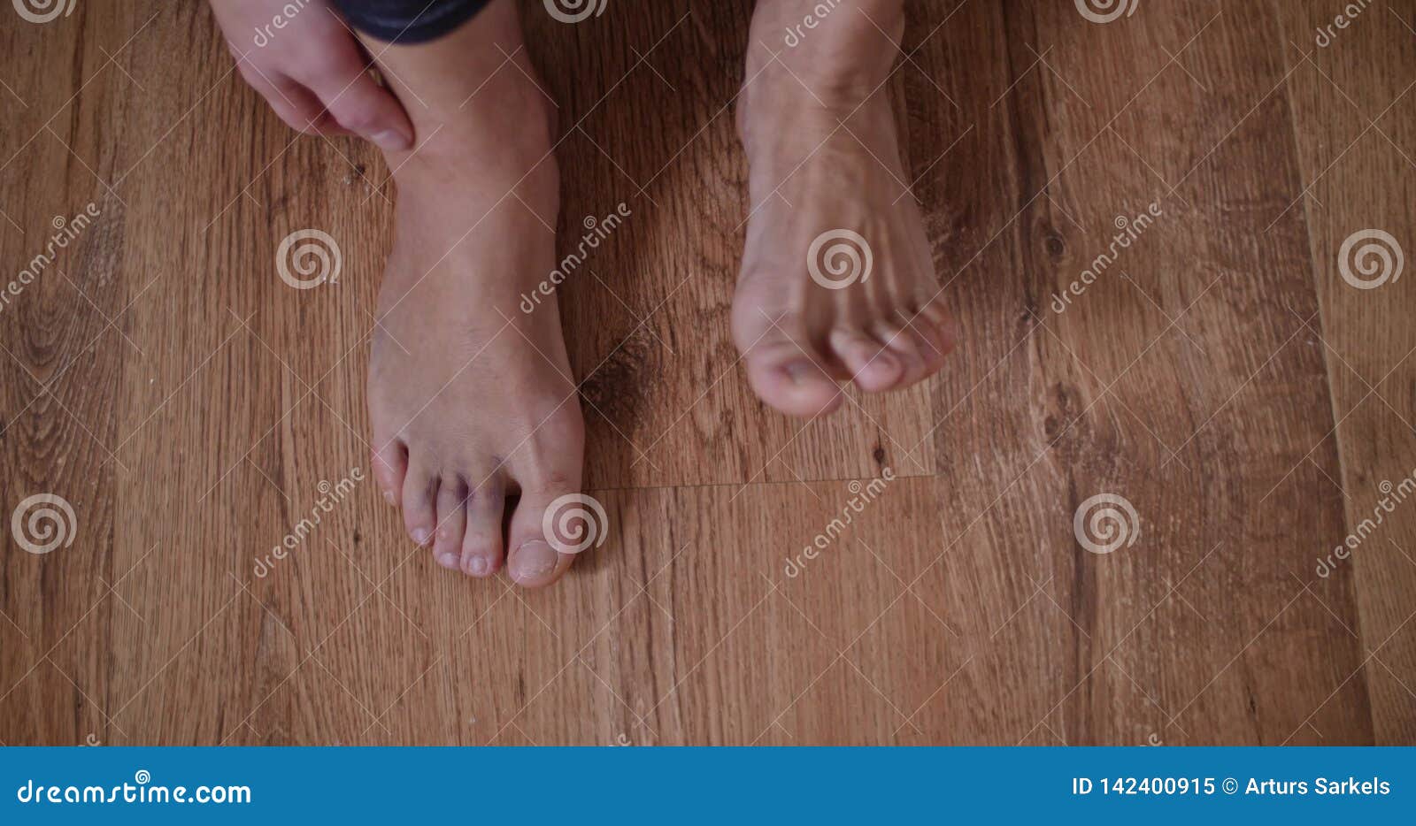 Men Leg after a Sprained Ligament Injury Close Up Stock Video - Video ...