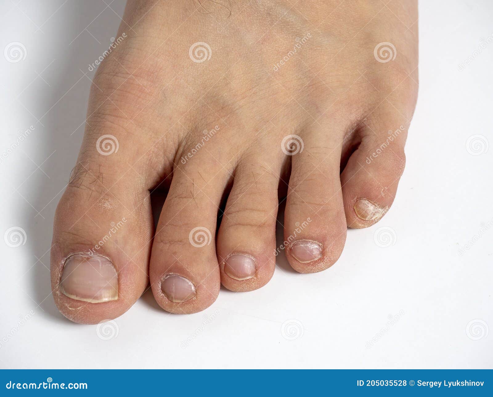 Men`s Foot Problems on the Skin and on the Nails Stock Photo - Image of ...