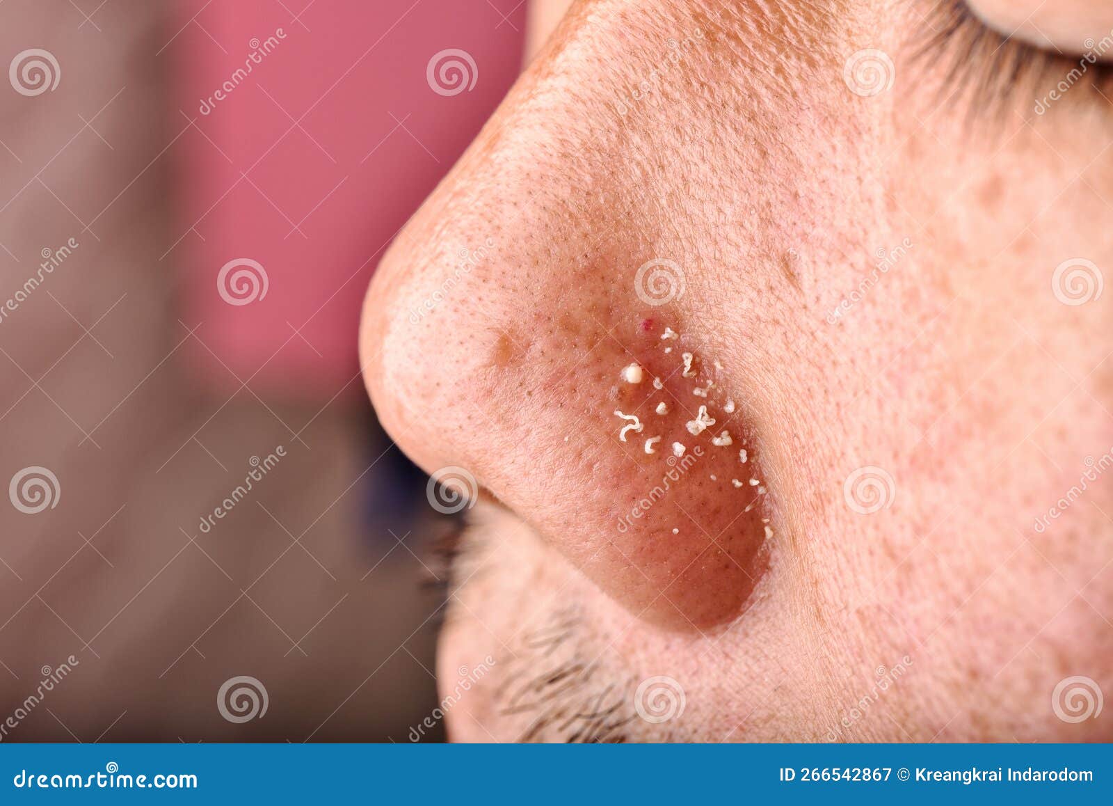 Men Skin Problem, Acne Squeeze, Whitehead Comedone Pus Extraction ... Men Skin Problem, Acne Squeeze, Whitehead Comedone Pus Extraction ...