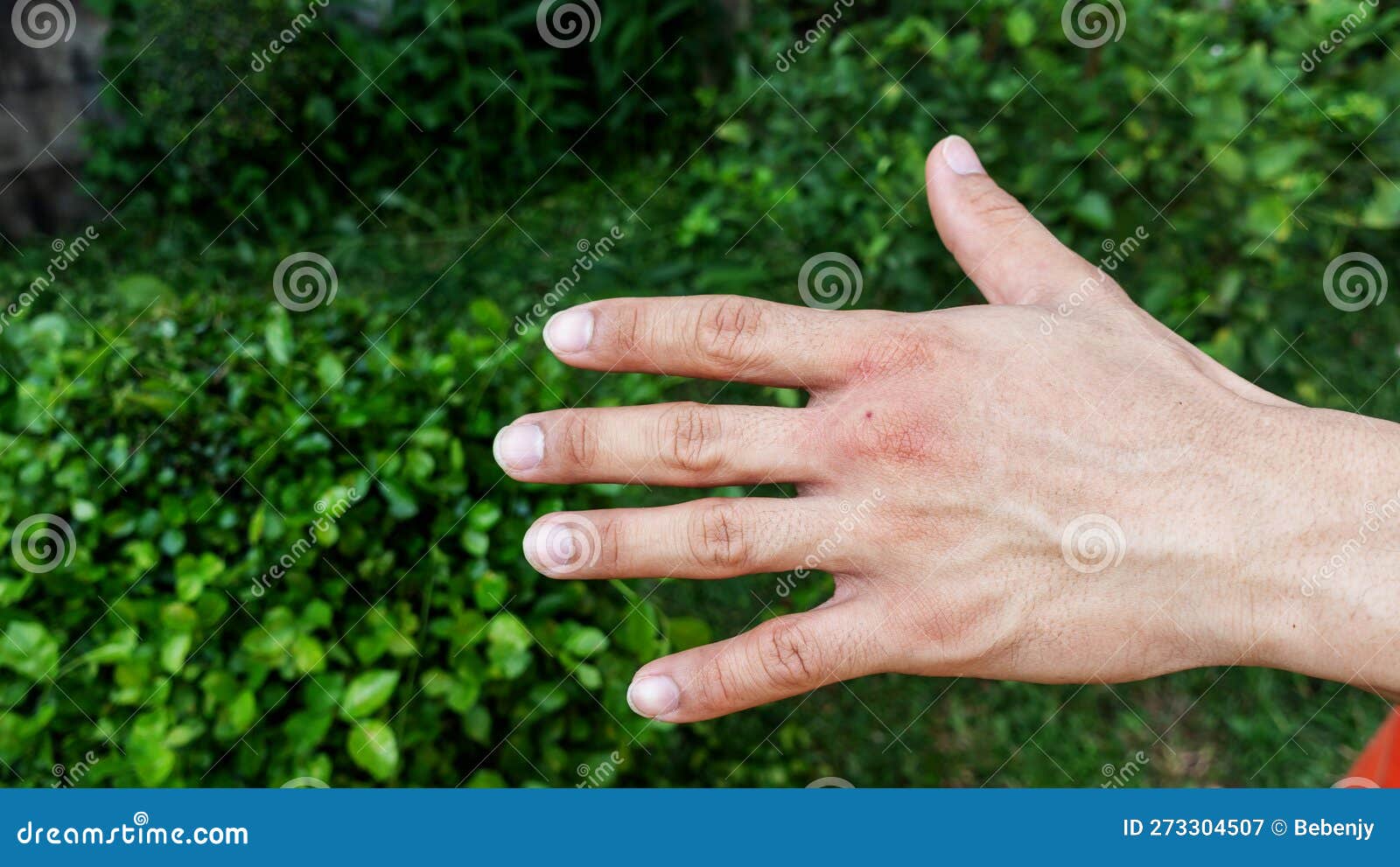 Men Were Bitten by an Insect Stock Image - Image of care, protection ...