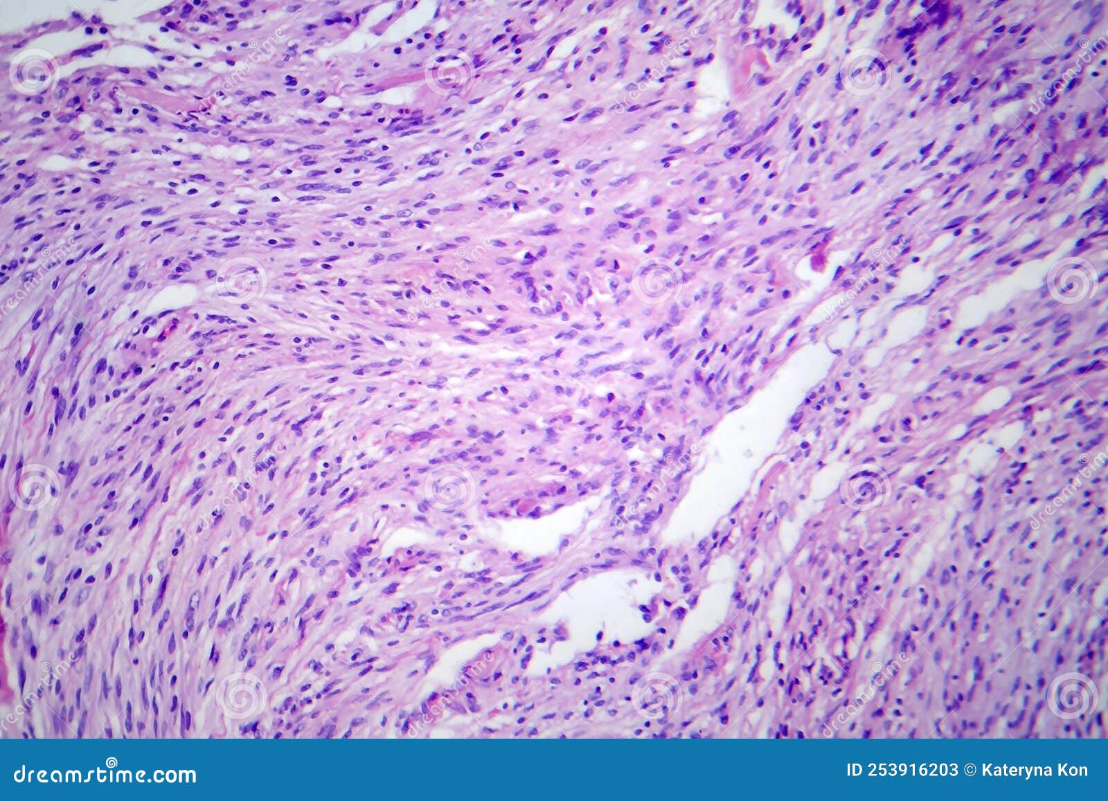 Meningioma, Light Micrograph, Photo Under Microscope Stock Image ...