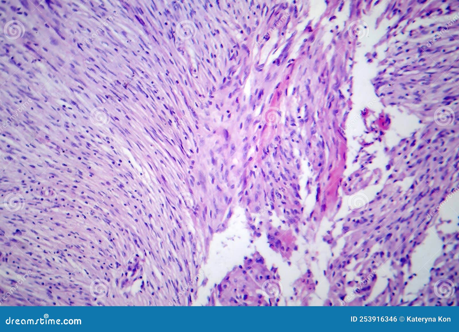 Meningioma, Light Micrograph, Photo Under Microscope Stock Photo ...