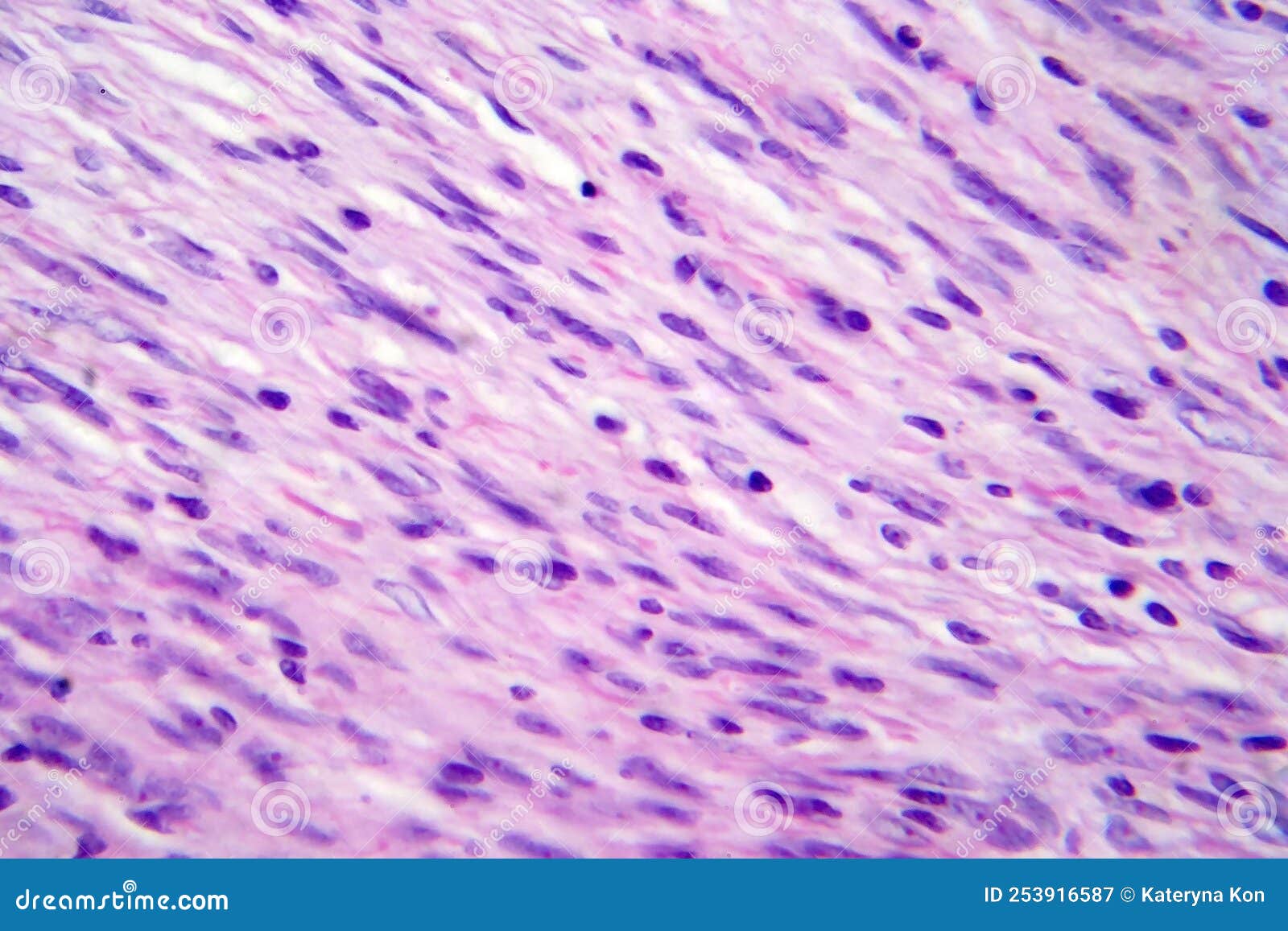 Meningioma, Light Micrograph, Photo Under Microscope Stock Image ...