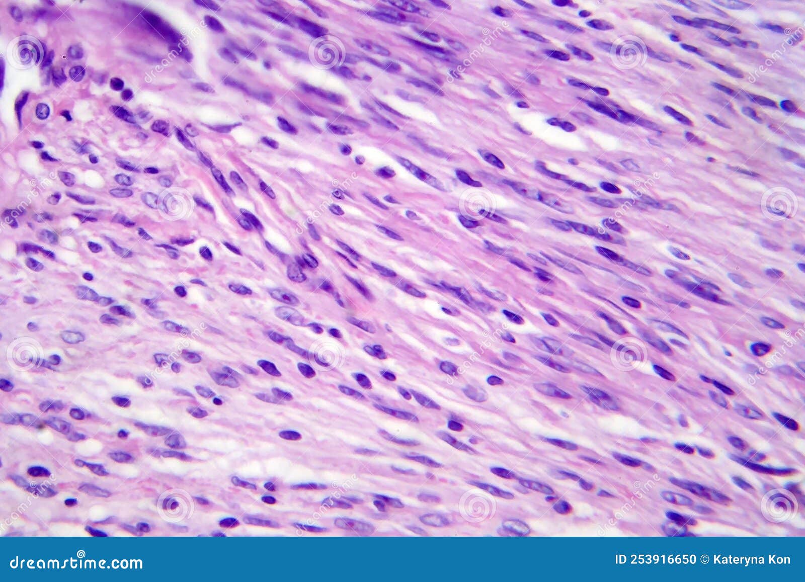 Meningioma, Light Micrograph, Photo Under Microscope Stock Photo ...