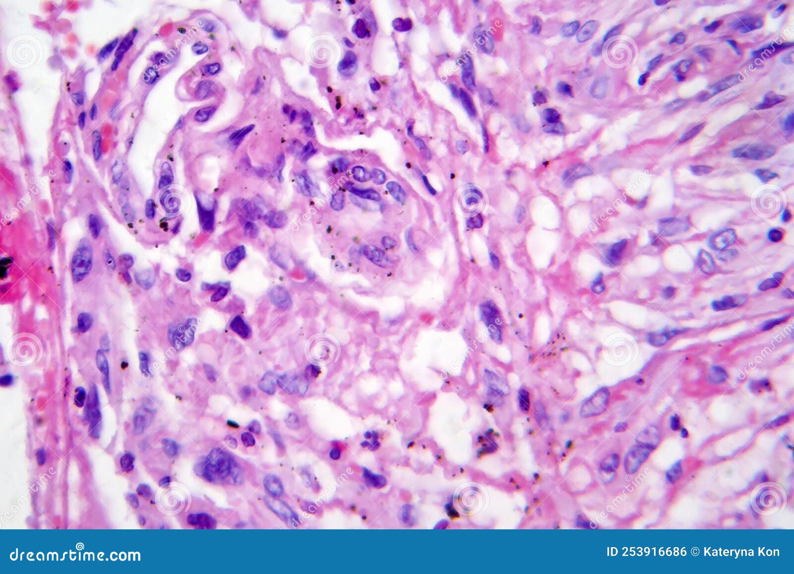 Meningioma, Light Micrograph, Photo Under Microscope Stock Photo ...