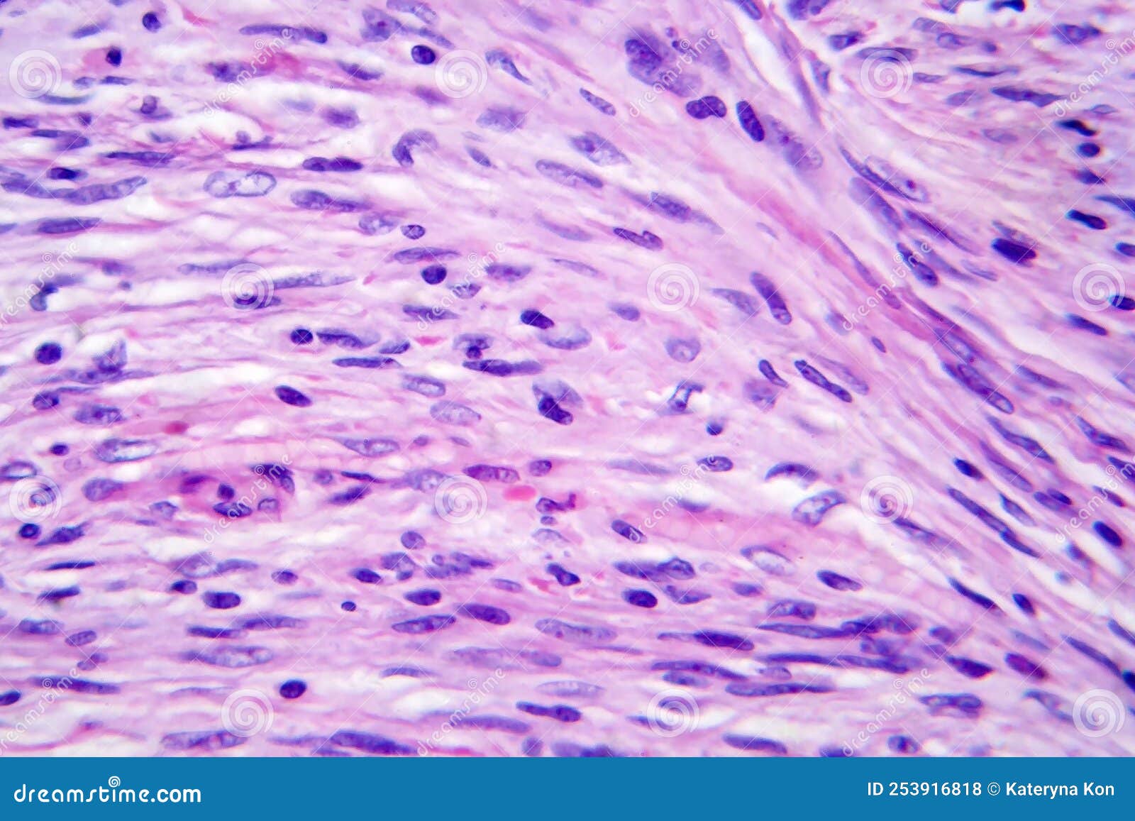 Meningioma, Light Micrograph, Photo Under Microscope Stock Photo ...