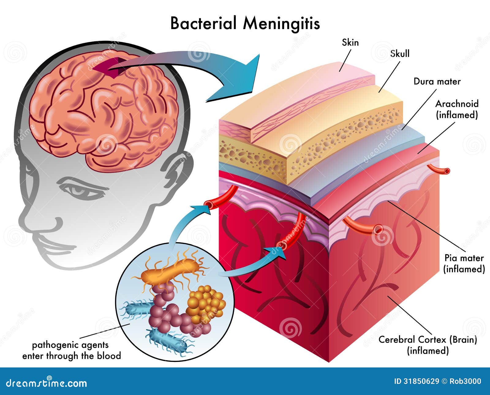 Meningite batterica illustrazione vettoriale. Illustrazione di cervello ...