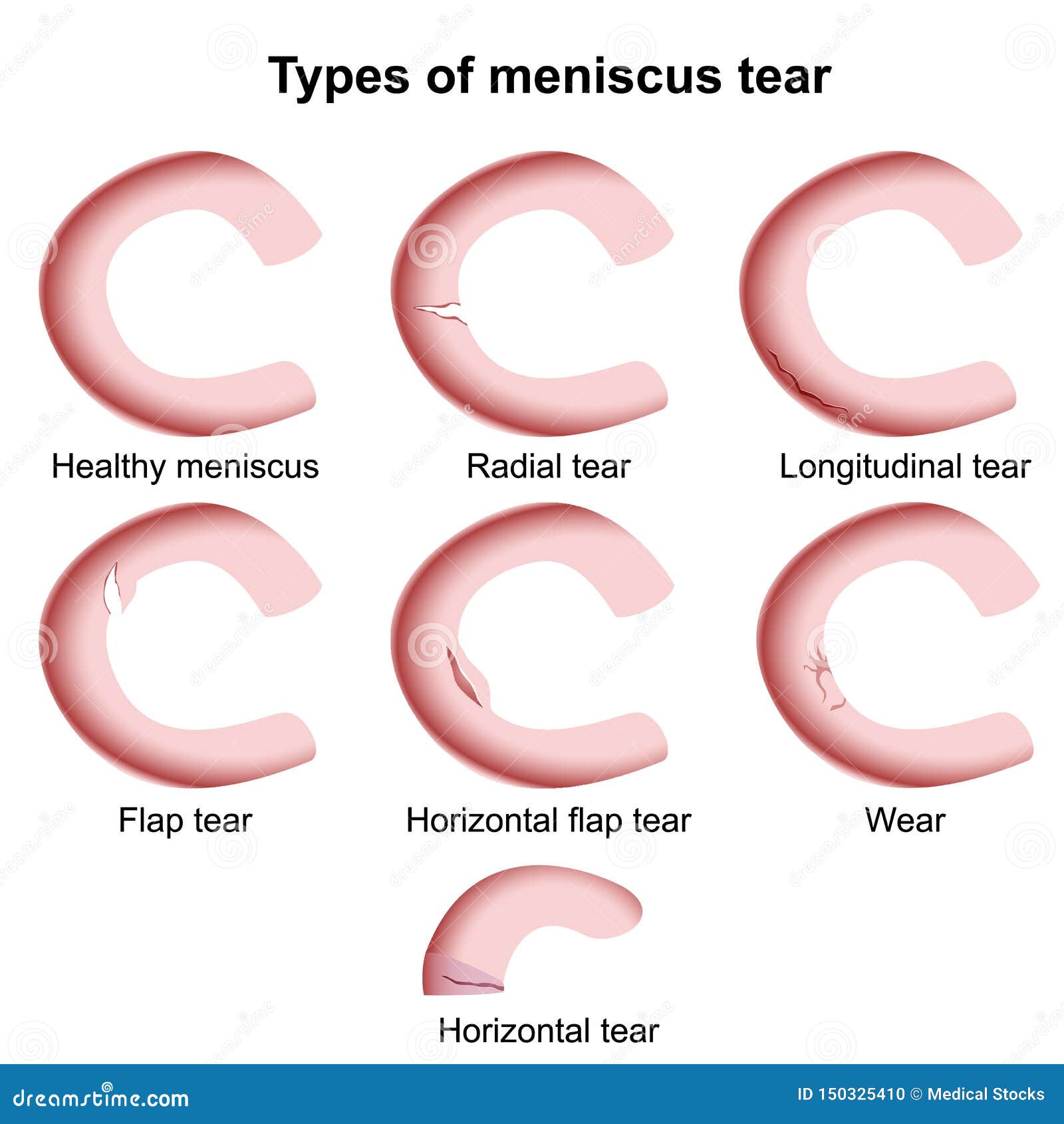 Meniscus Injuries Medical Vector Illustration Isolated On White Background Meniscus Tear Stock